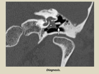 Presentation1, quiz for the petrous bone and para nasal sinuses. | PPTX