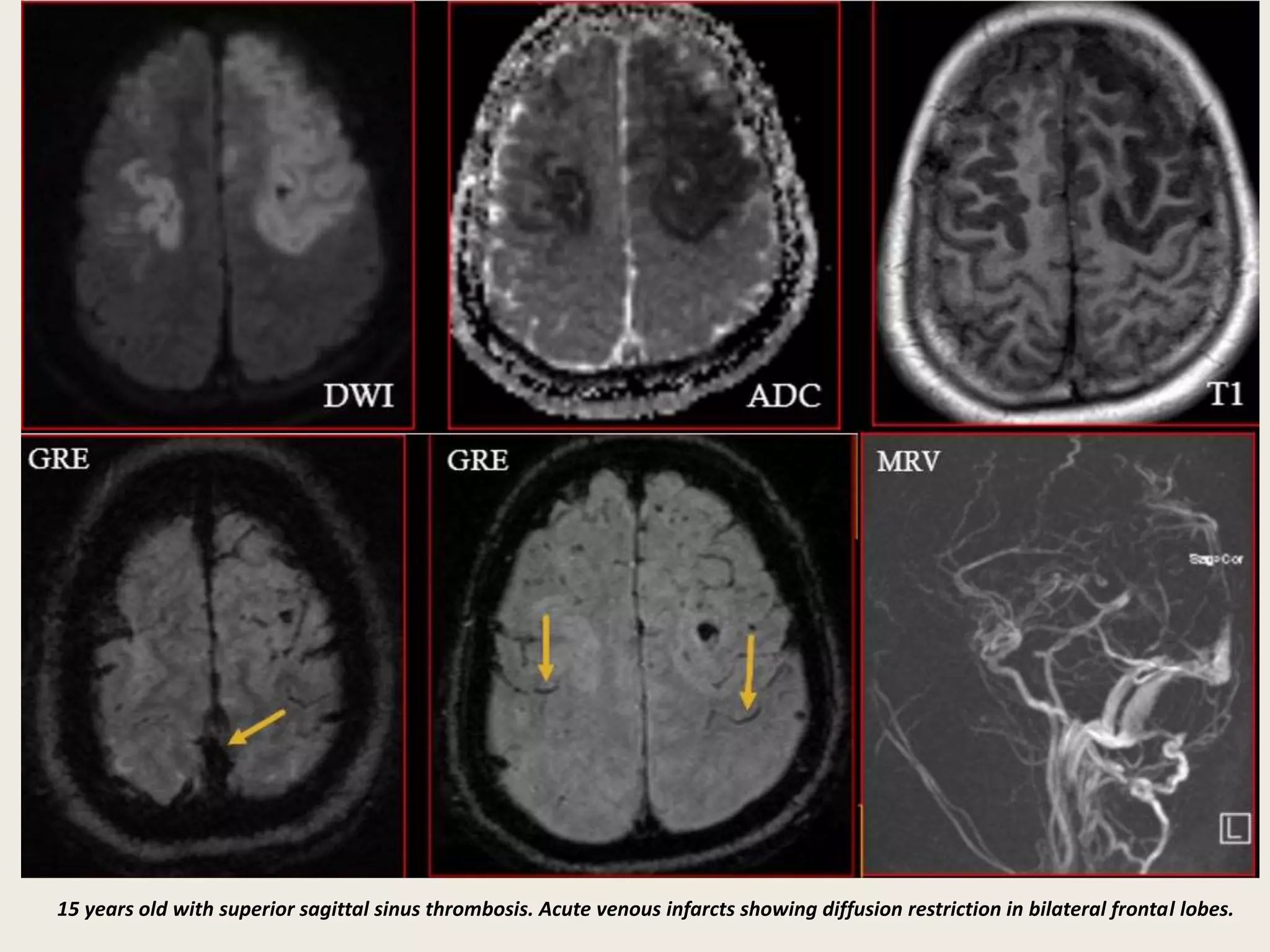 Presentation1, radiological application of diffusion weighted imges in ...