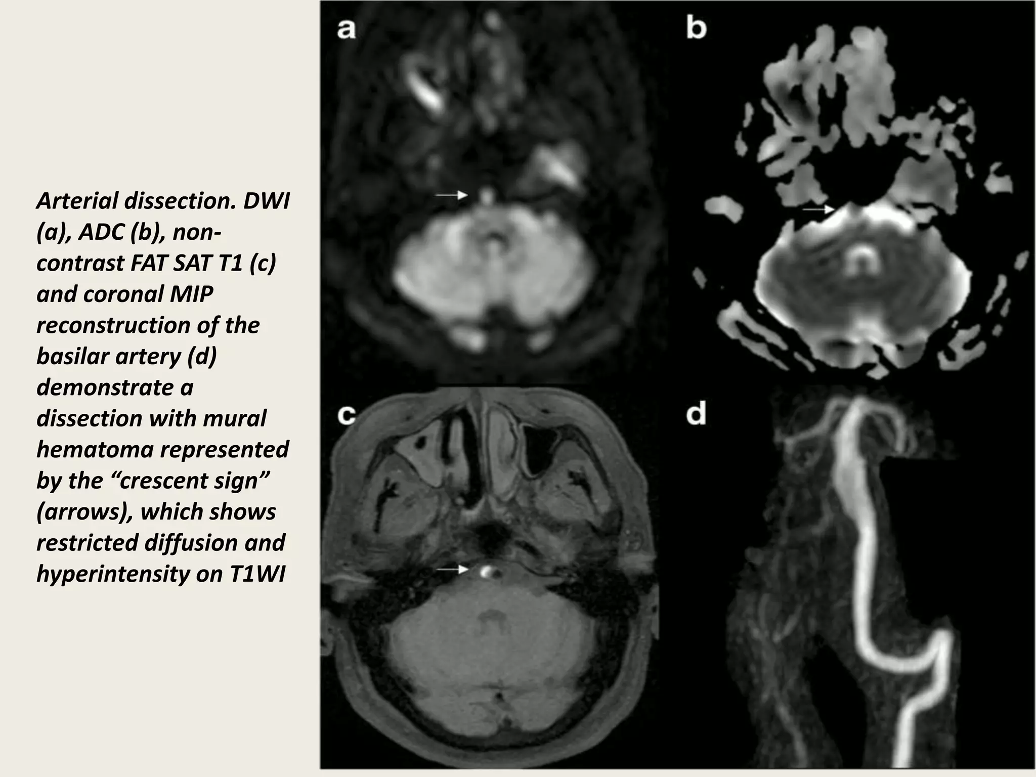 Presentation1, radiological application of diffusion weighted imges in ...