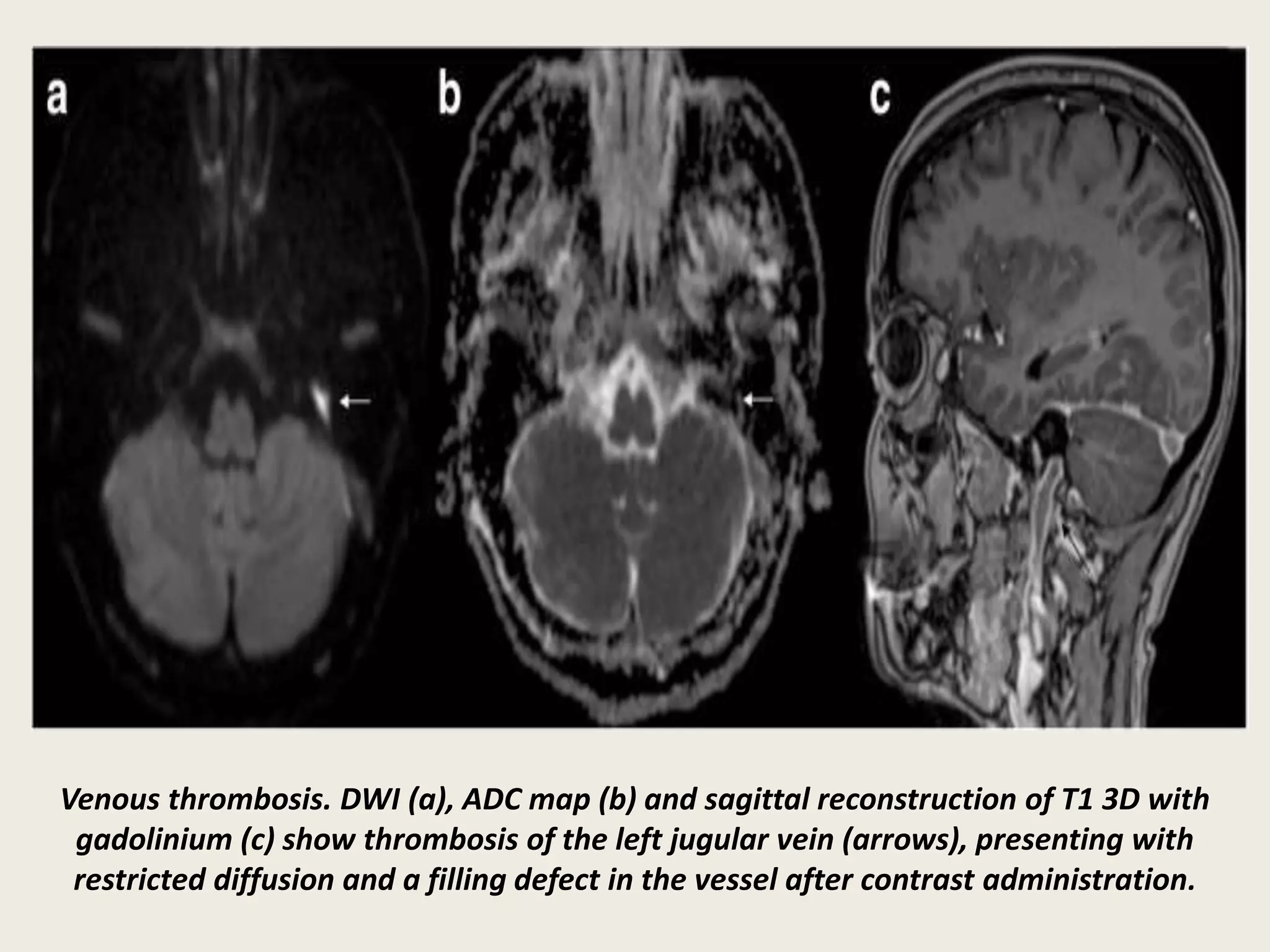 Presentation1, radiological application of diffusion weighted imges in ...