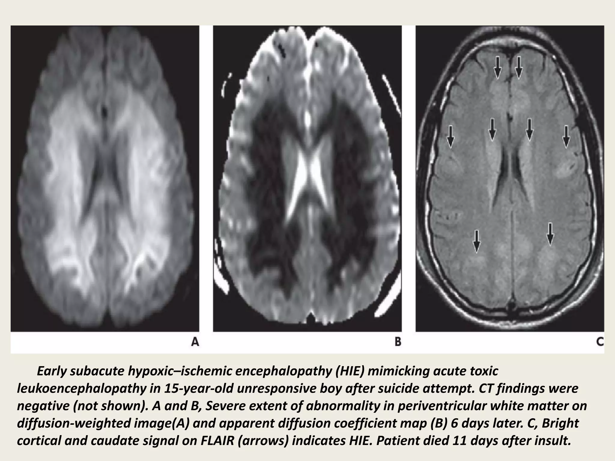 Presentation1, radiological application of diffusion weighted imges in ...