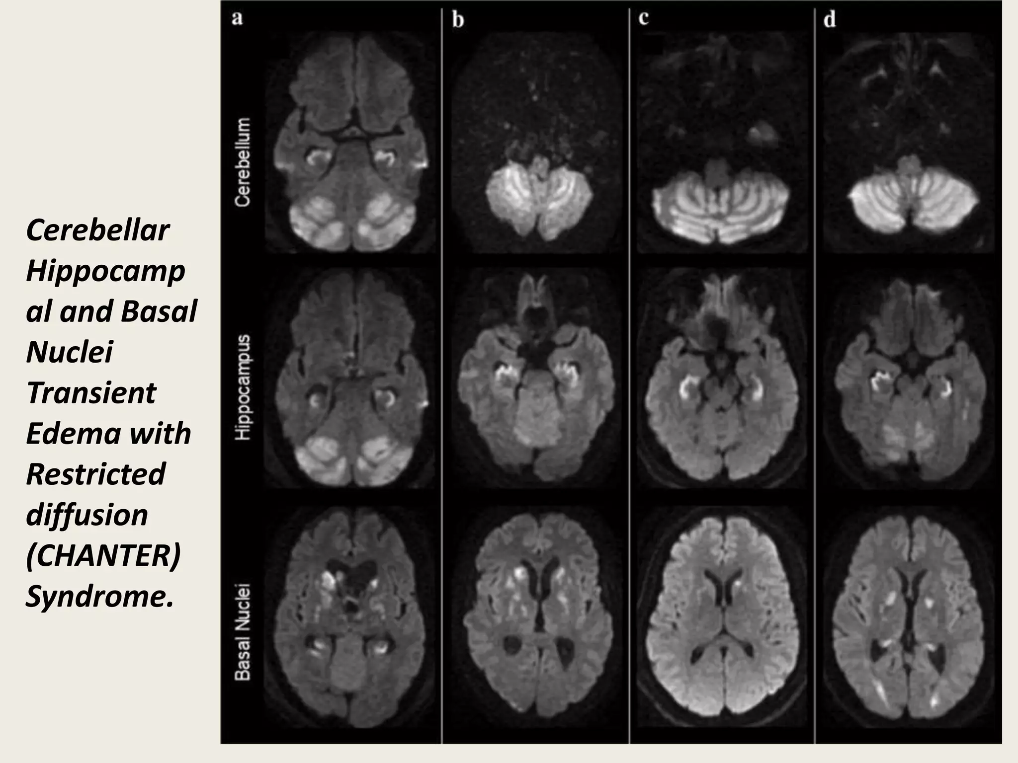 Presentation1, radiological application of diffusion weighted imges in ...