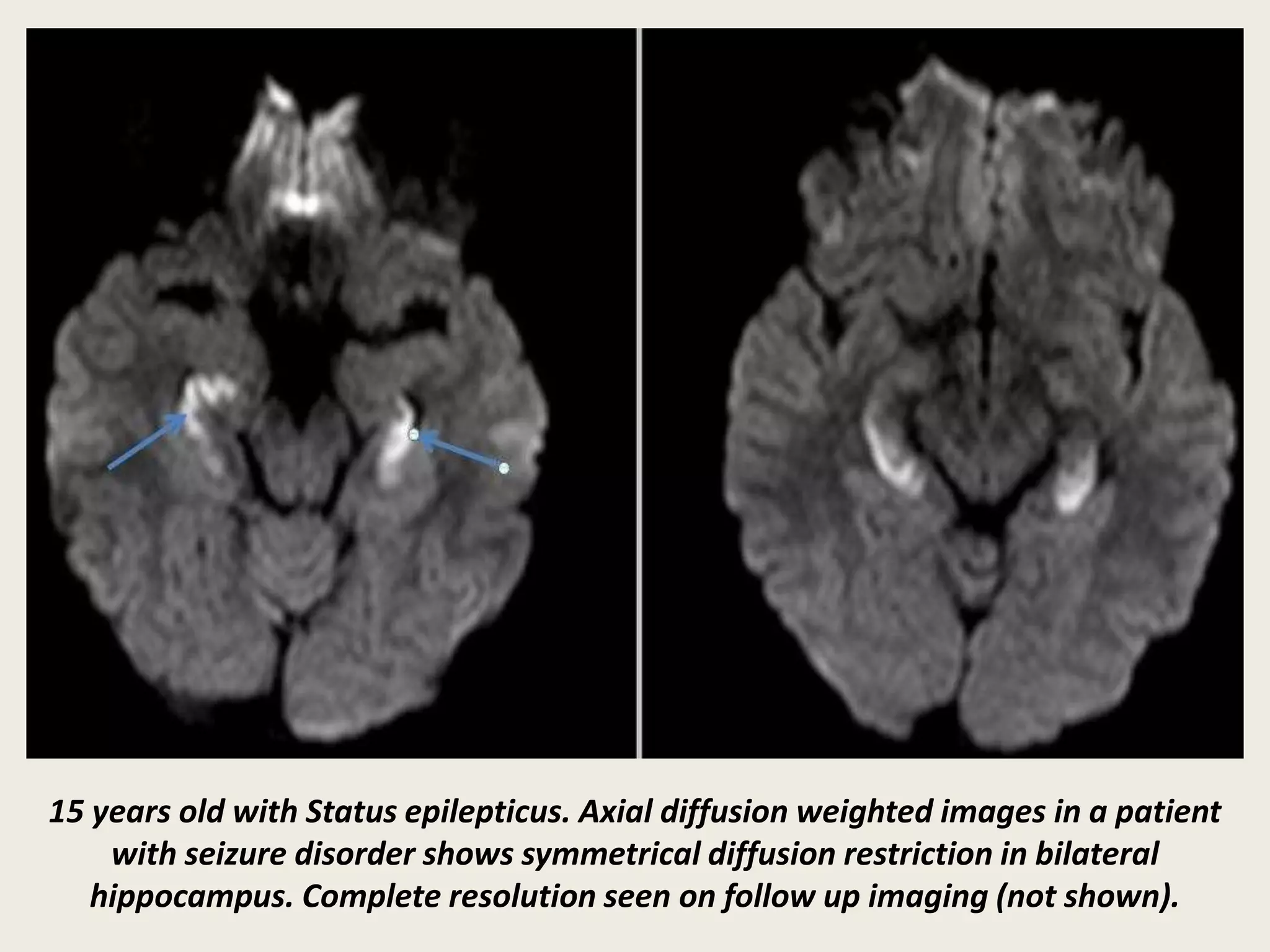 Presentation1, radiological application of diffusion weighted imges in ...