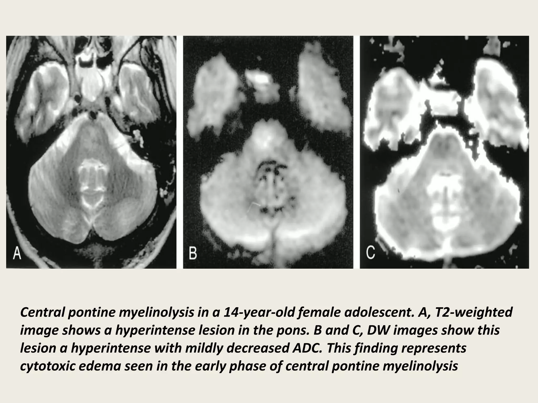 Presentation1, radiological application of diffusion weighted imges in ...
