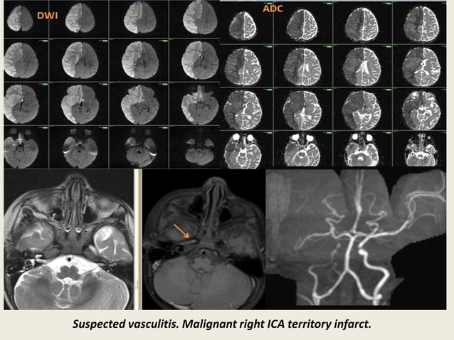 Presentation1, radiological application of diffusion weighted imges in ...