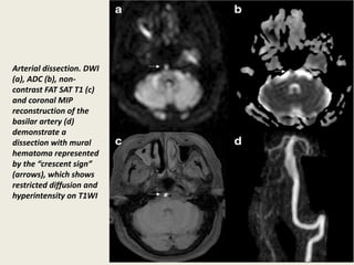 Presentation1, radiological application of diffusion weighted imges in ...
