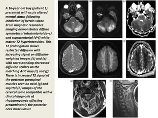 Presentation1, radiological application of diffusion weighted imges in ...