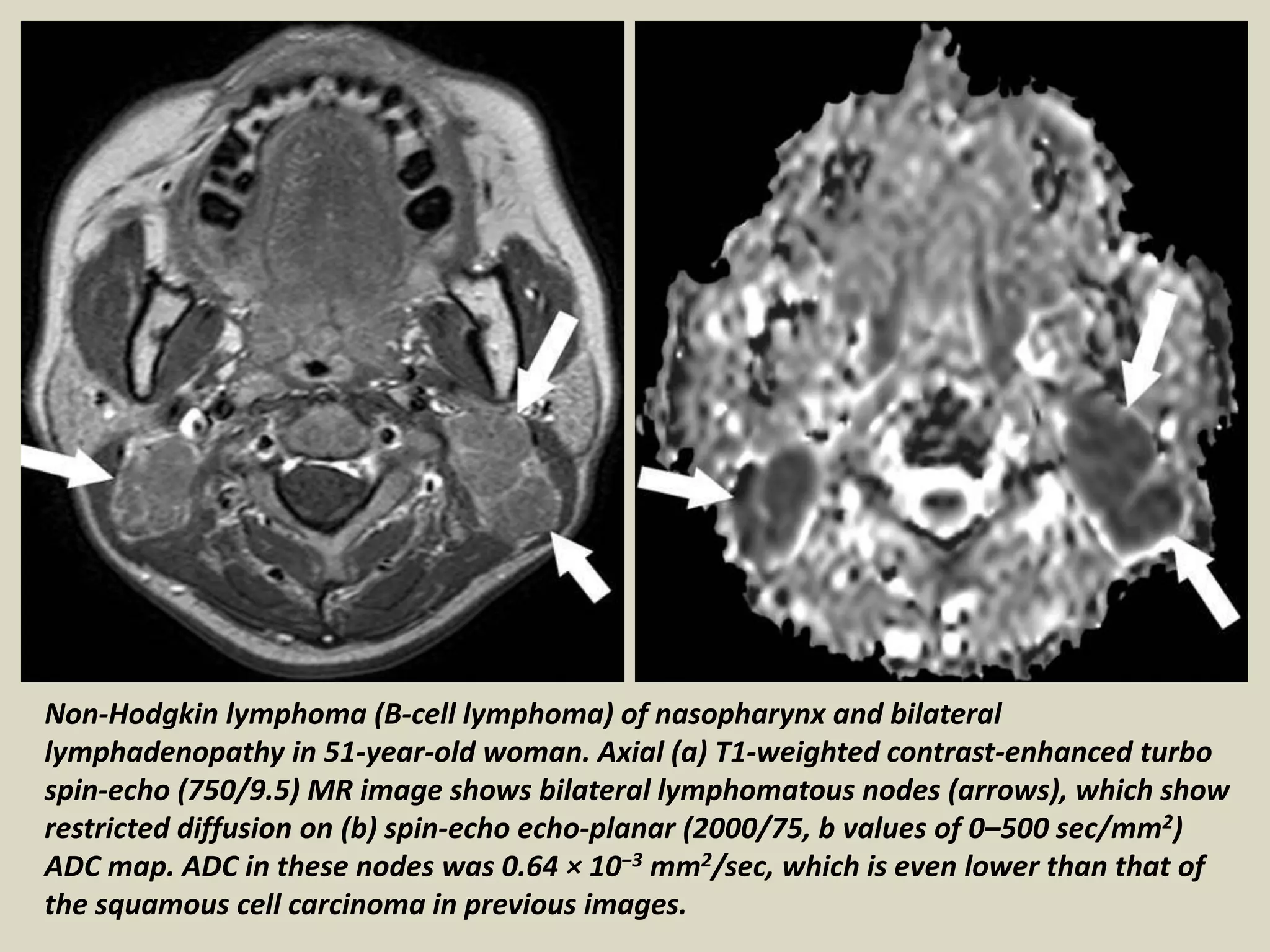 Presentation1, radiological application of diffusion weighted mri in ...