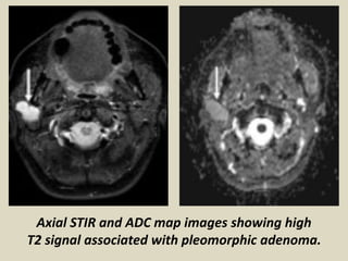 Presentation1, radiological application of diffusion weighted mri in ...