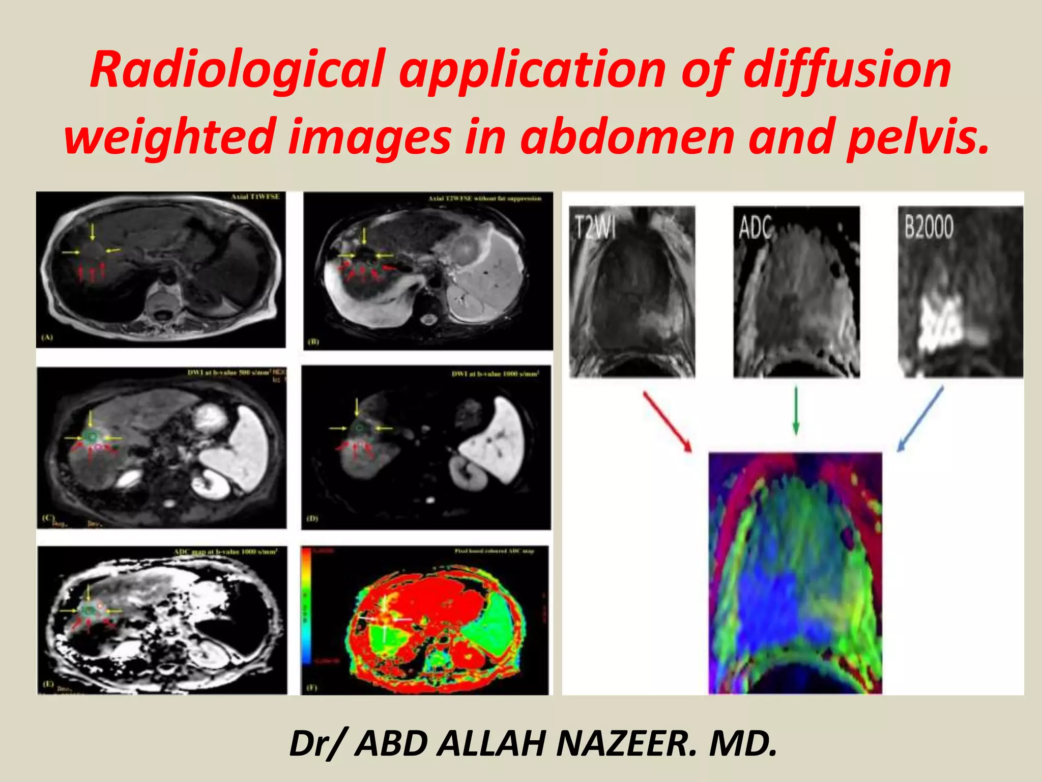 Presentation1, radiological application of diffusion weighted images in ...