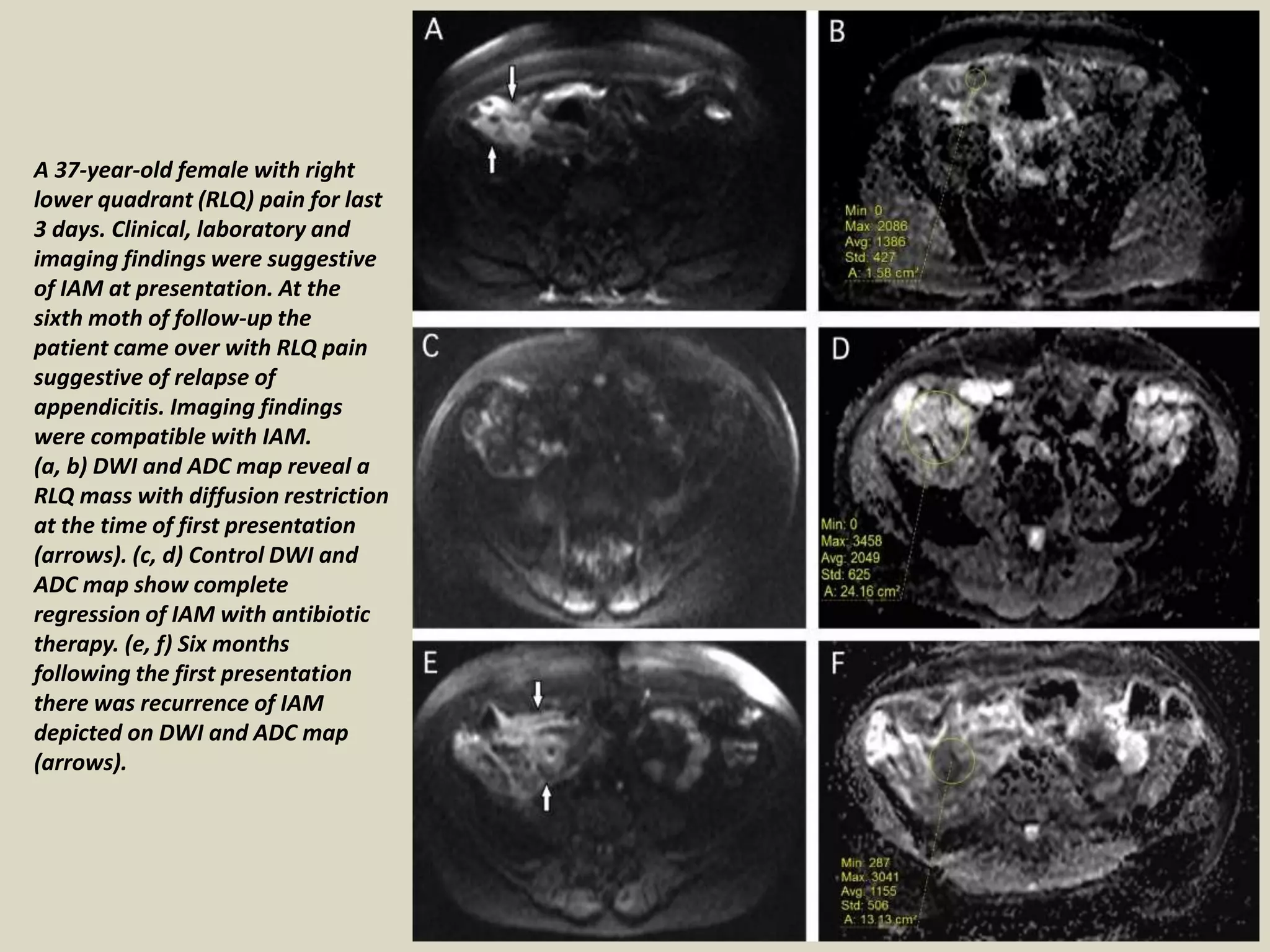 Presentation1, radiological application of diffusion weighted images in ...