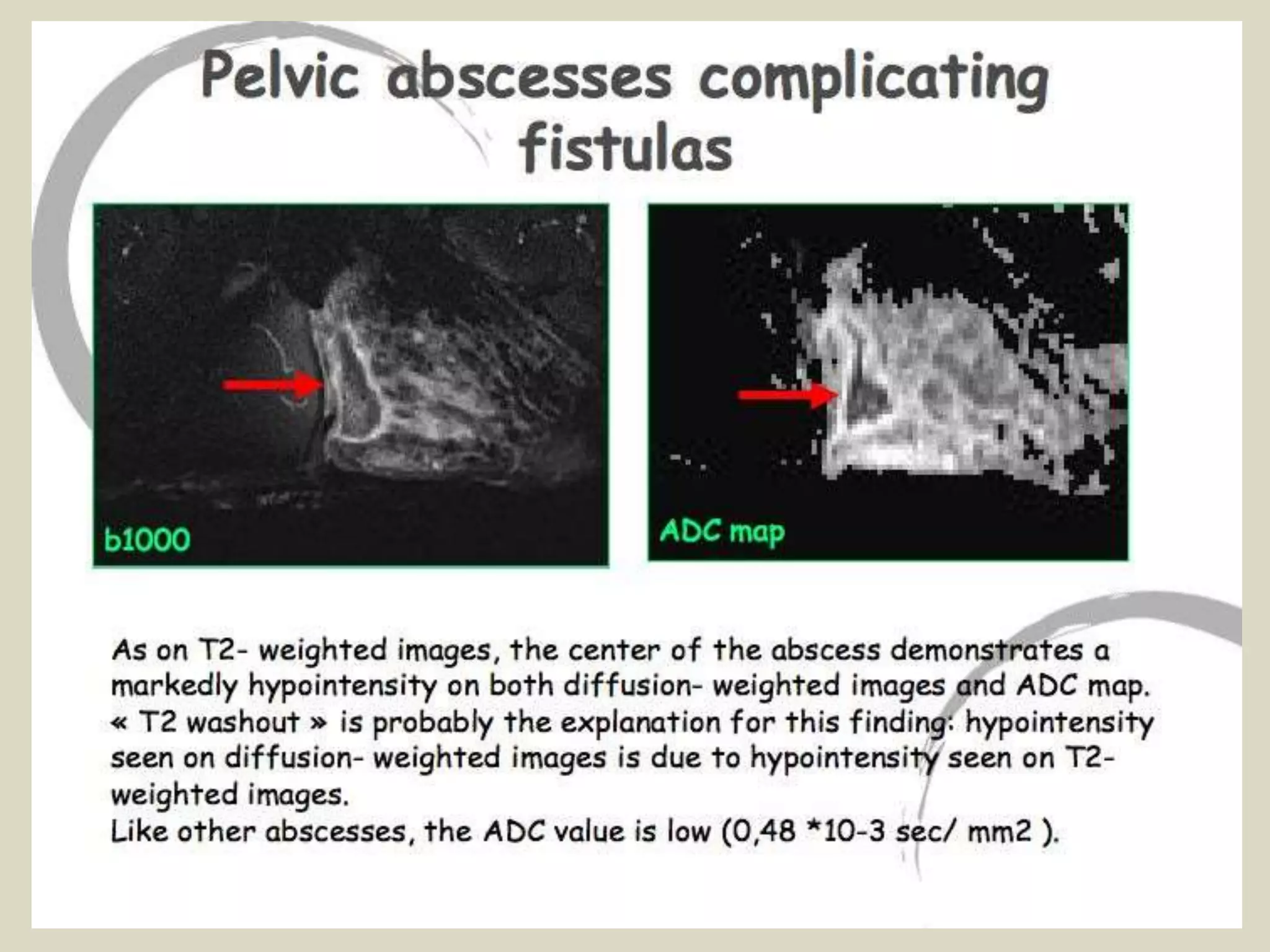 Presentation1, radiological application of diffusion weighted images in ...