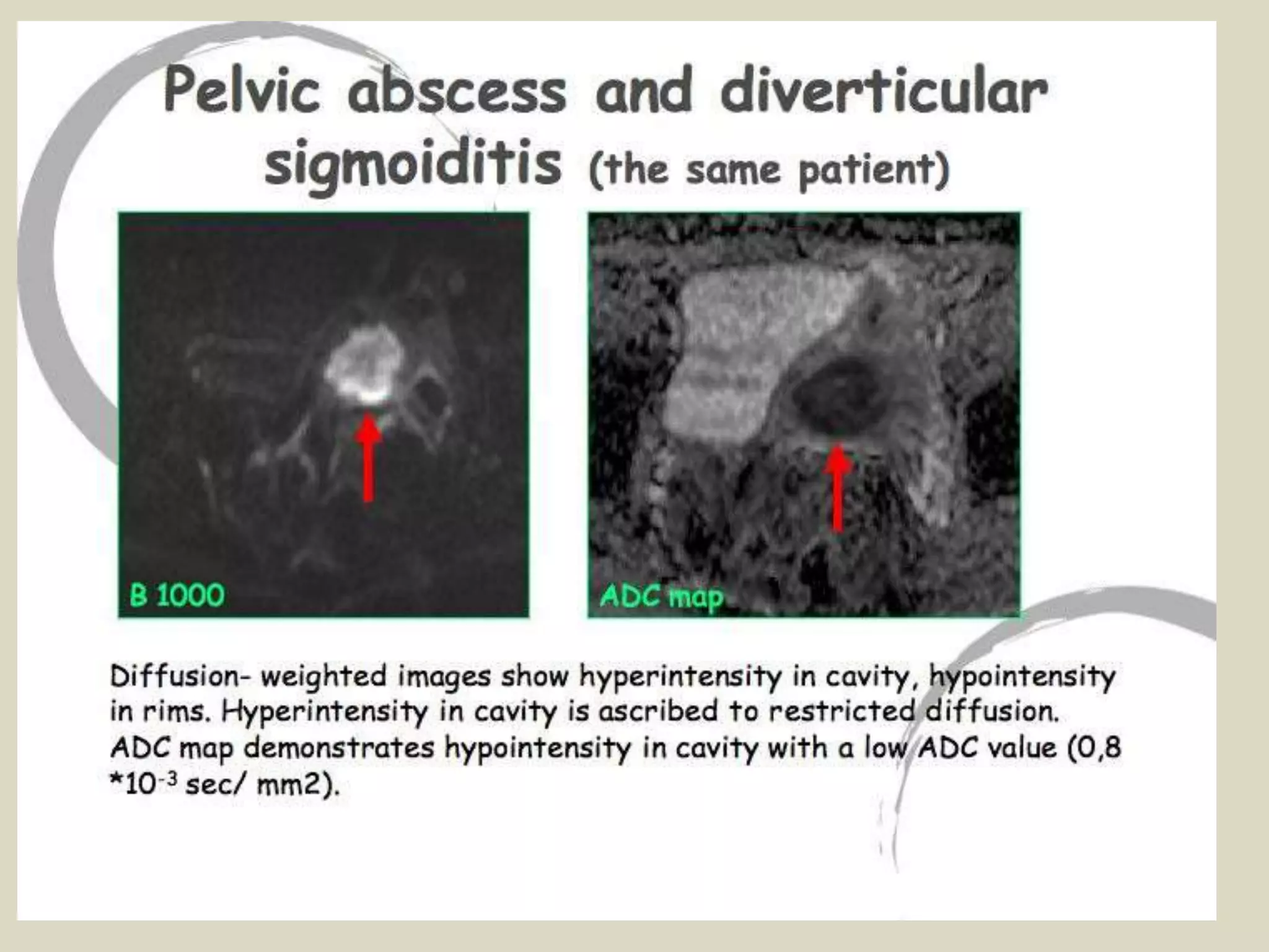 Presentation1, radiological application of diffusion weighted images in ...