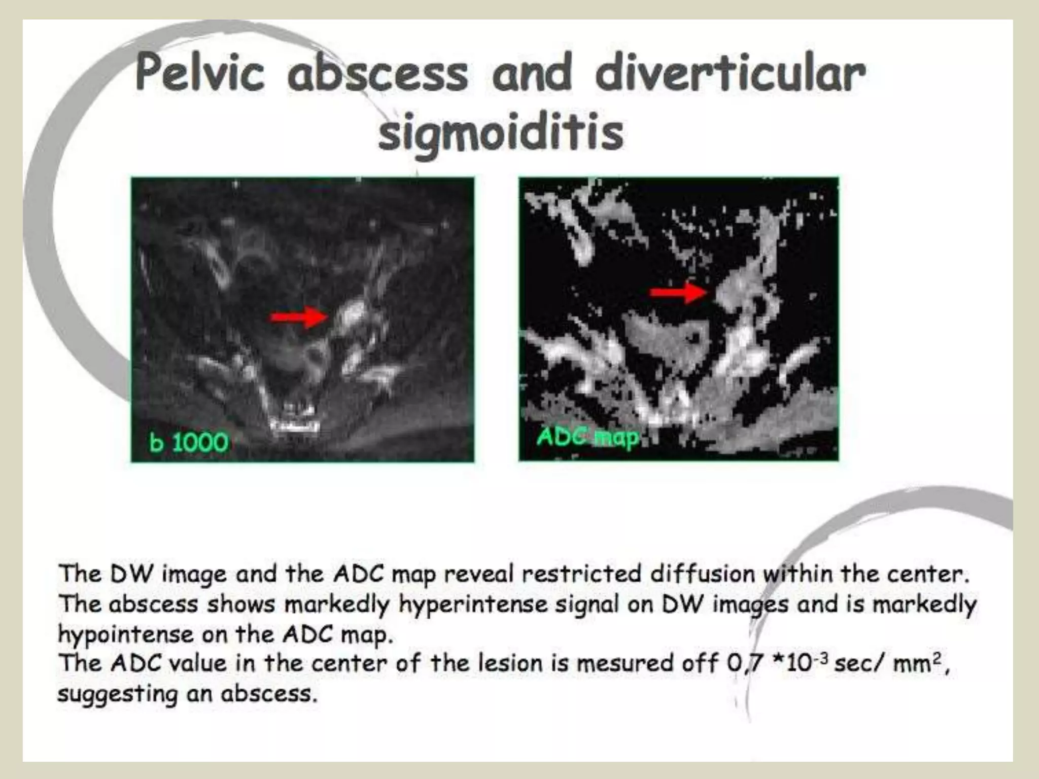 Presentation1, radiological application of diffusion weighted images in ...