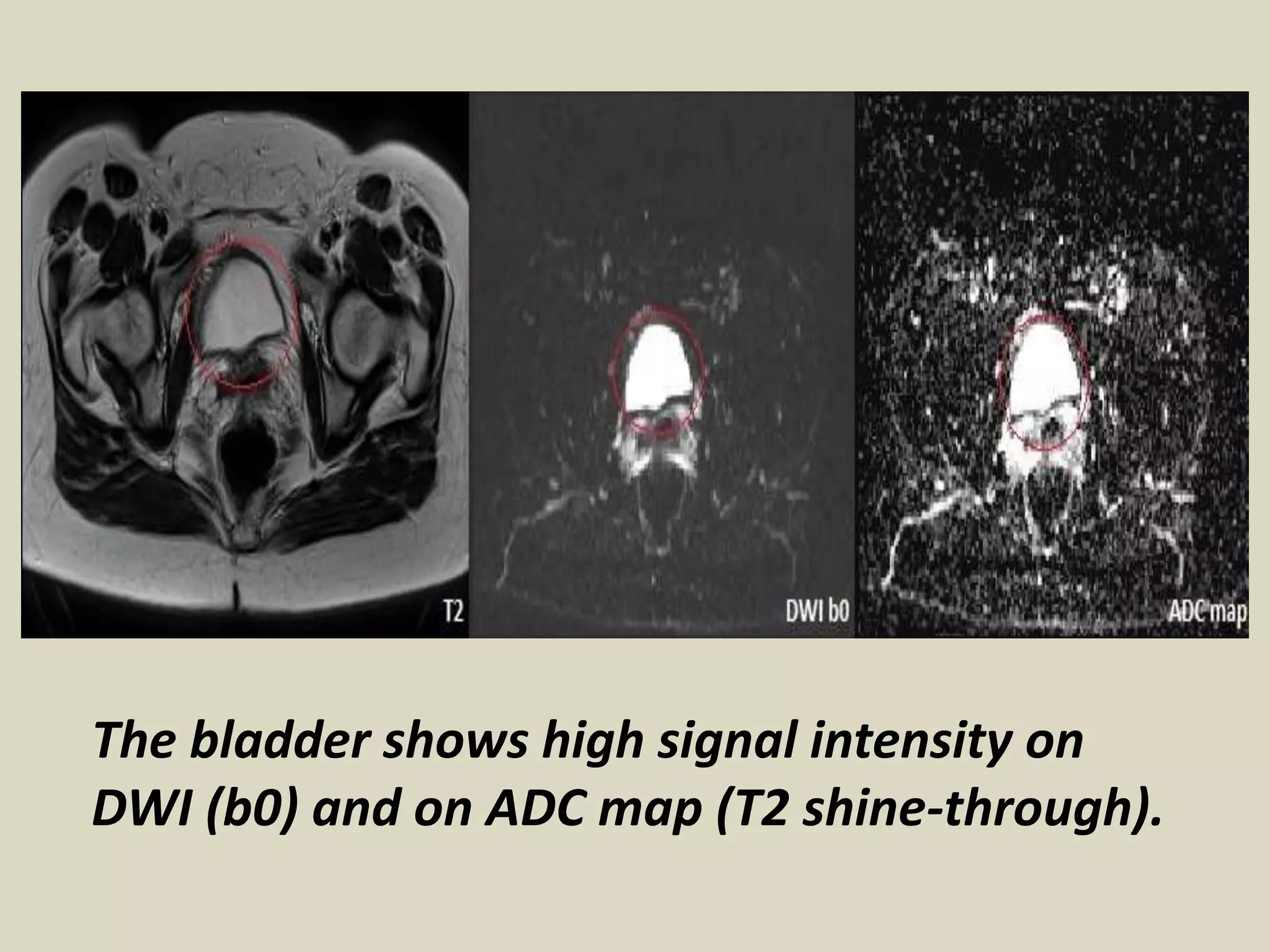 Presentation1, radiological application of diffusion weighted images in ...
