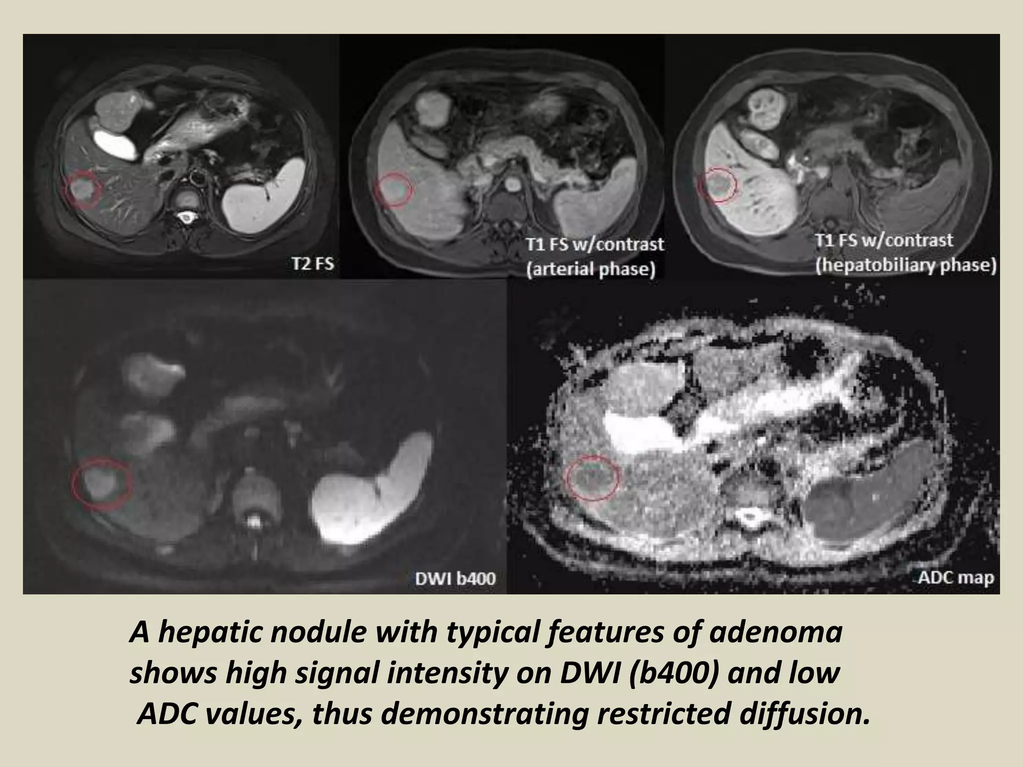 Presentation1, radiological application of diffusion weighted images in ...