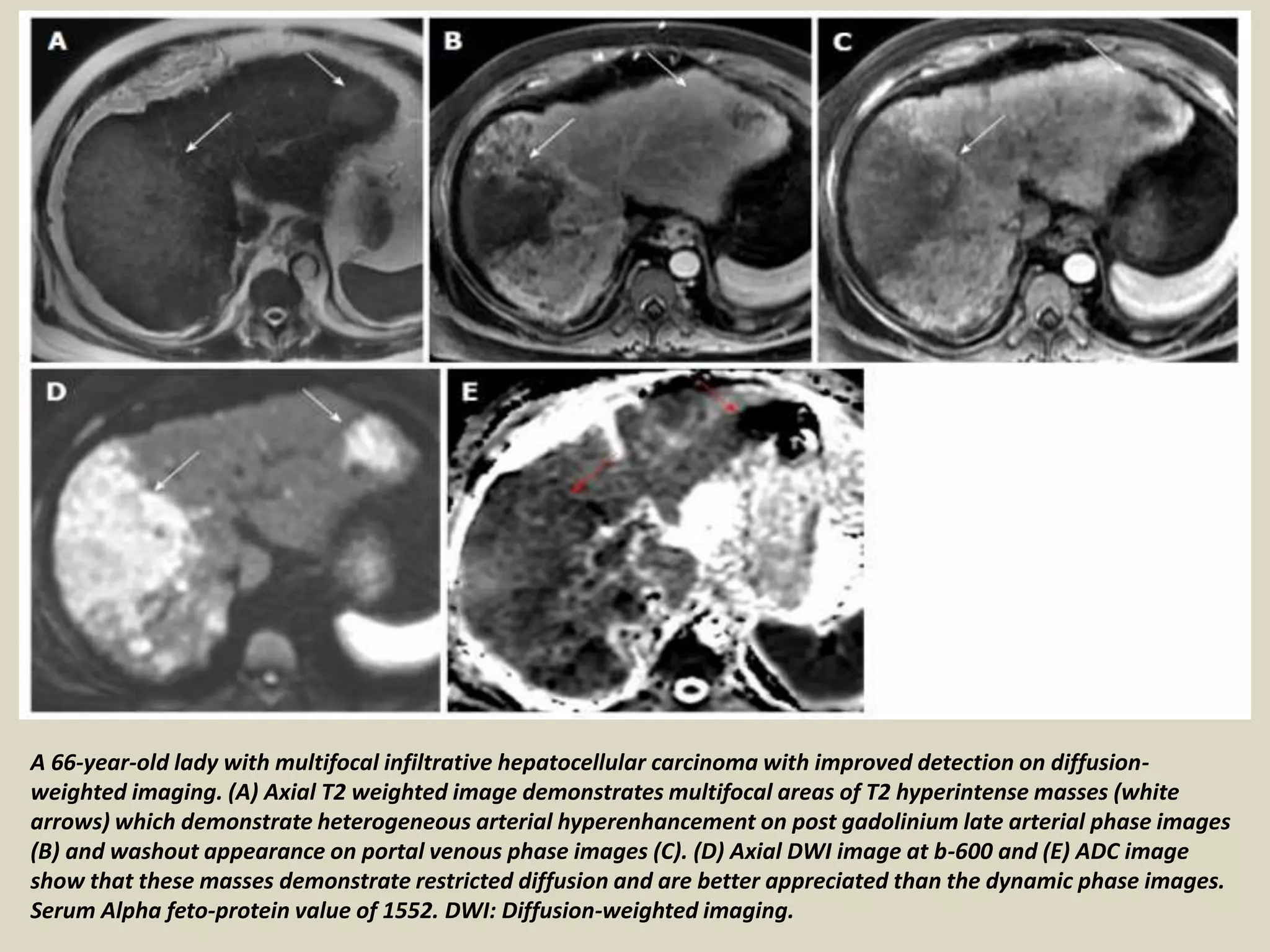 Presentation1, radiological application of diffusion weighted images in ...
