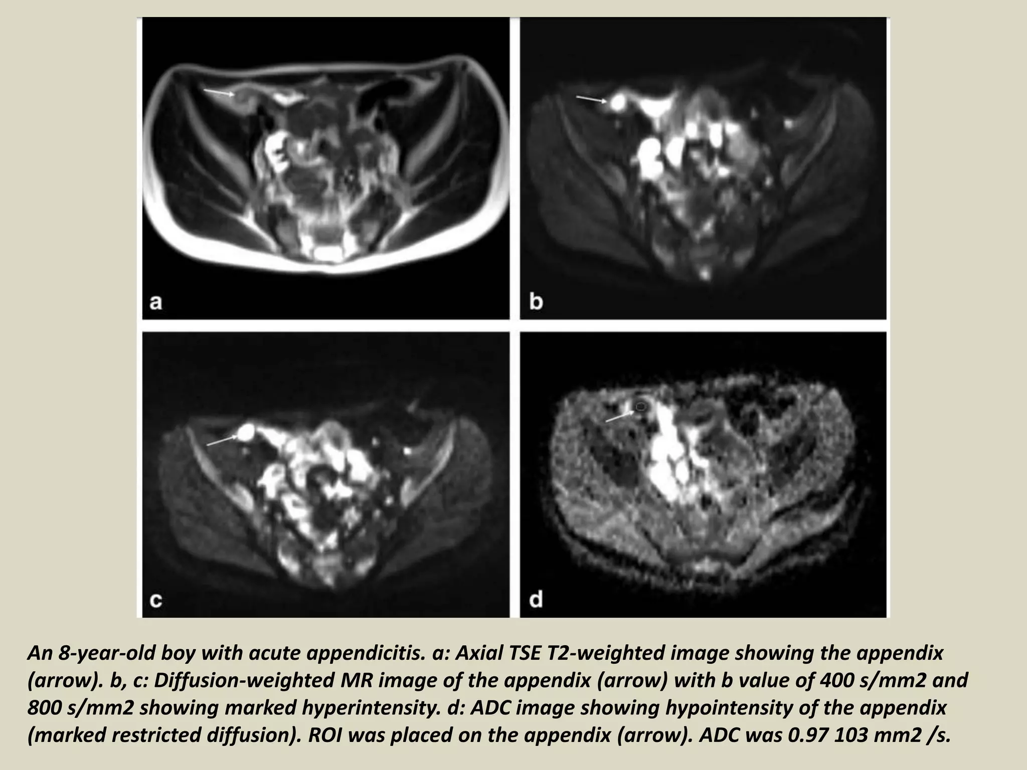 Presentation1, radiological application of diffusion weighted images in ...
