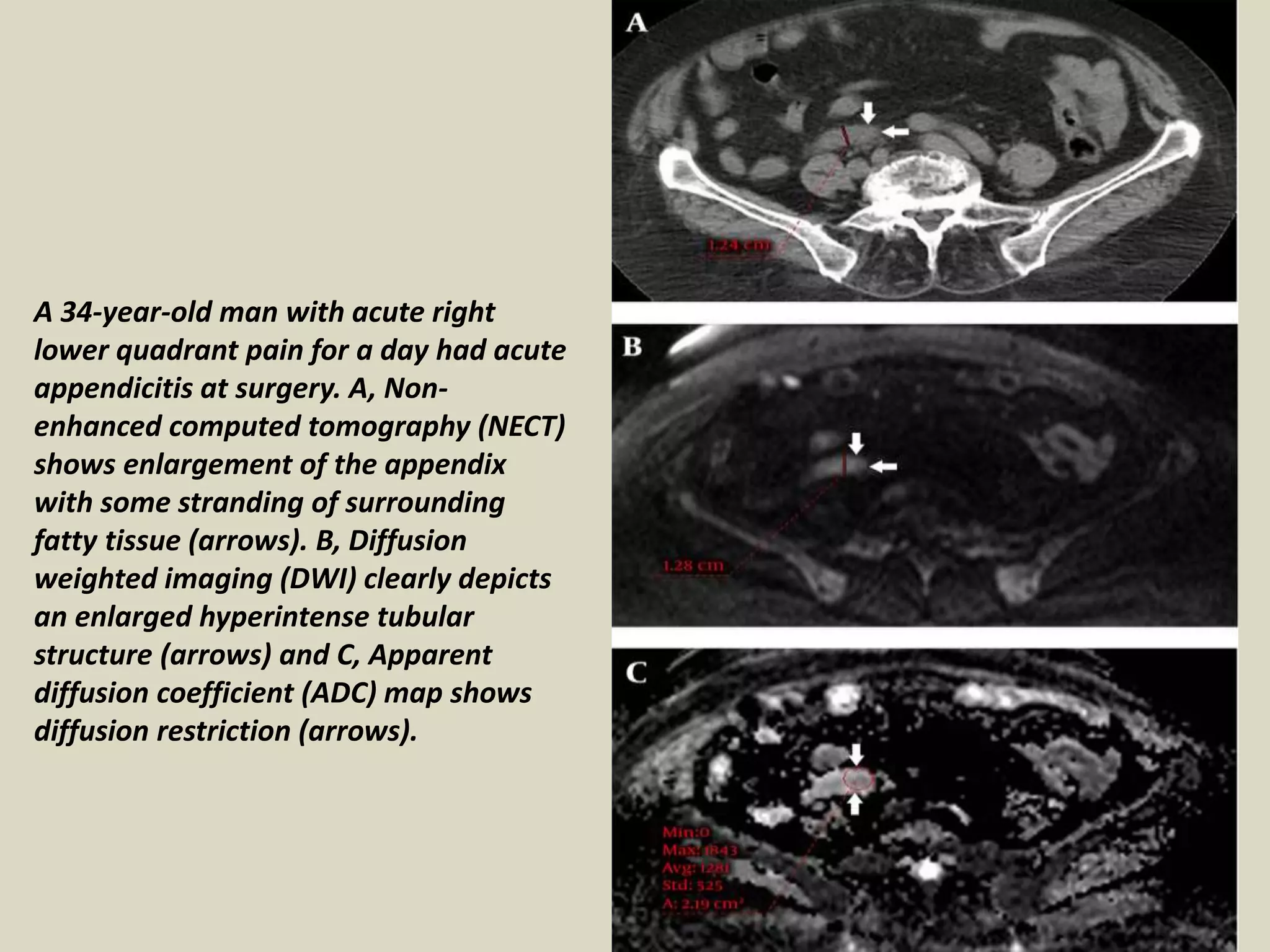 Presentation1, radiological application of diffusion weighted images in ...