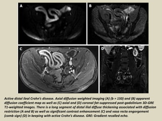 Presentation1, radiological application of diffusion weighted images in ...