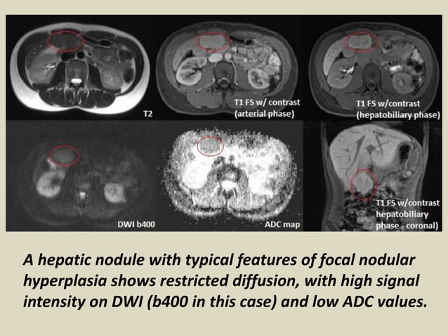 Presentation1, radiological application of diffusion weighted images in ...