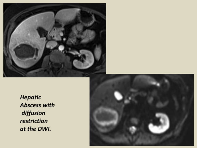 Presentation1, radiological application of diffusion weighted images in ...