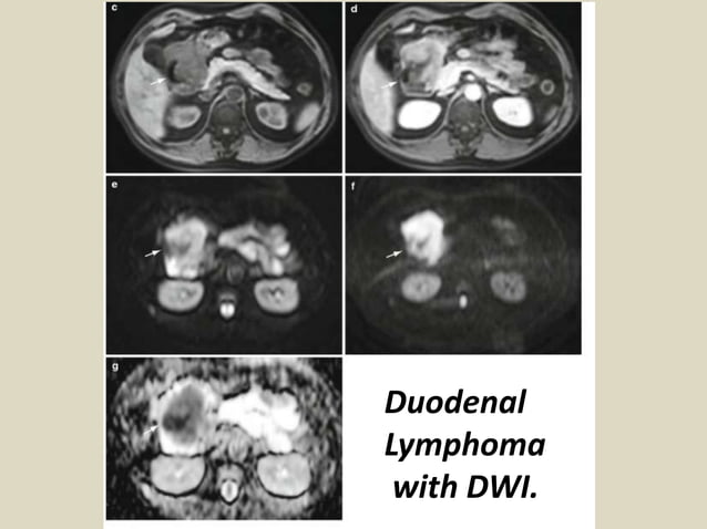 Presentation1, radiological application of diffusion weighted images in ...