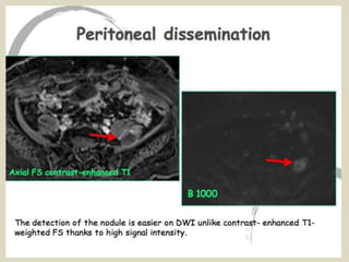 Presentation1, radiological application of diffusion weighted images in ...