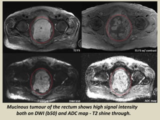 Presentation1, radiological application of diffusion weighted images in ...
