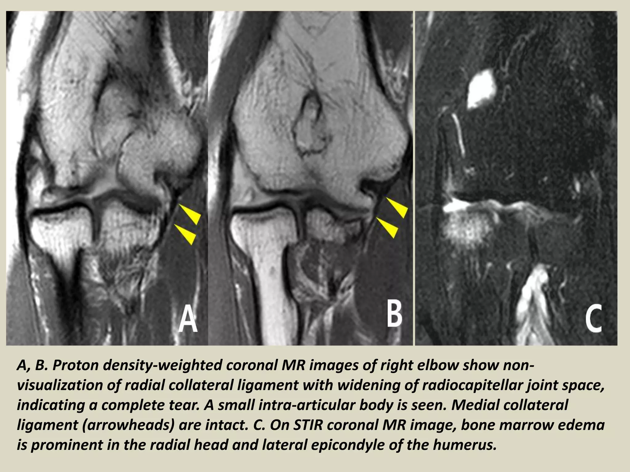 Presentation1, radiological film reading of elbow joint. | PPTX