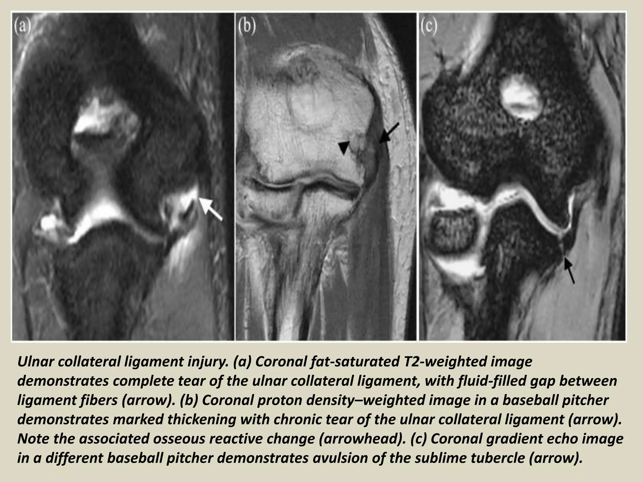 Presentation1, radiological film reading of elbow joint. | PPTX