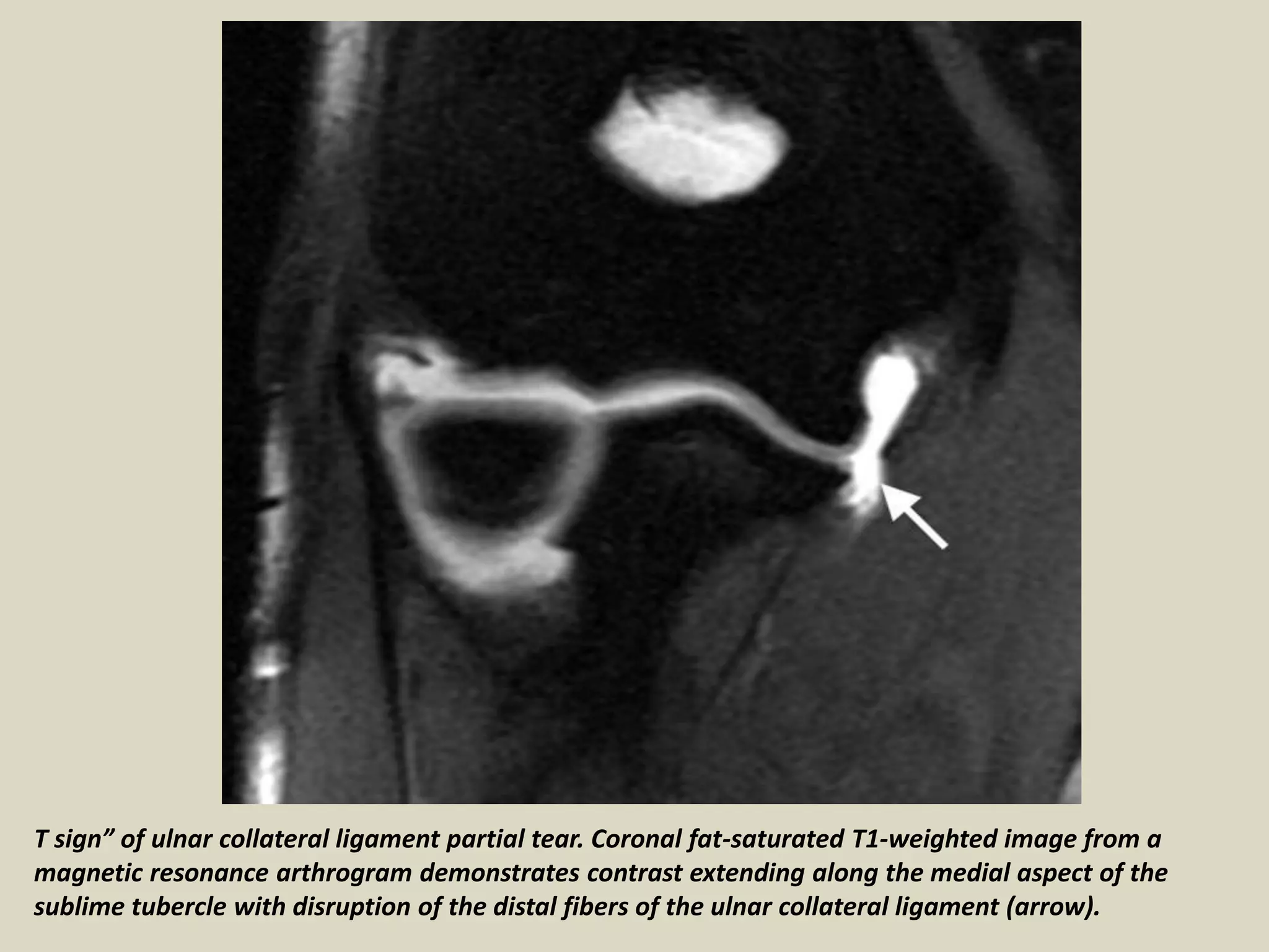 Presentation1, radiological film reading of elbow joint. | PPTX