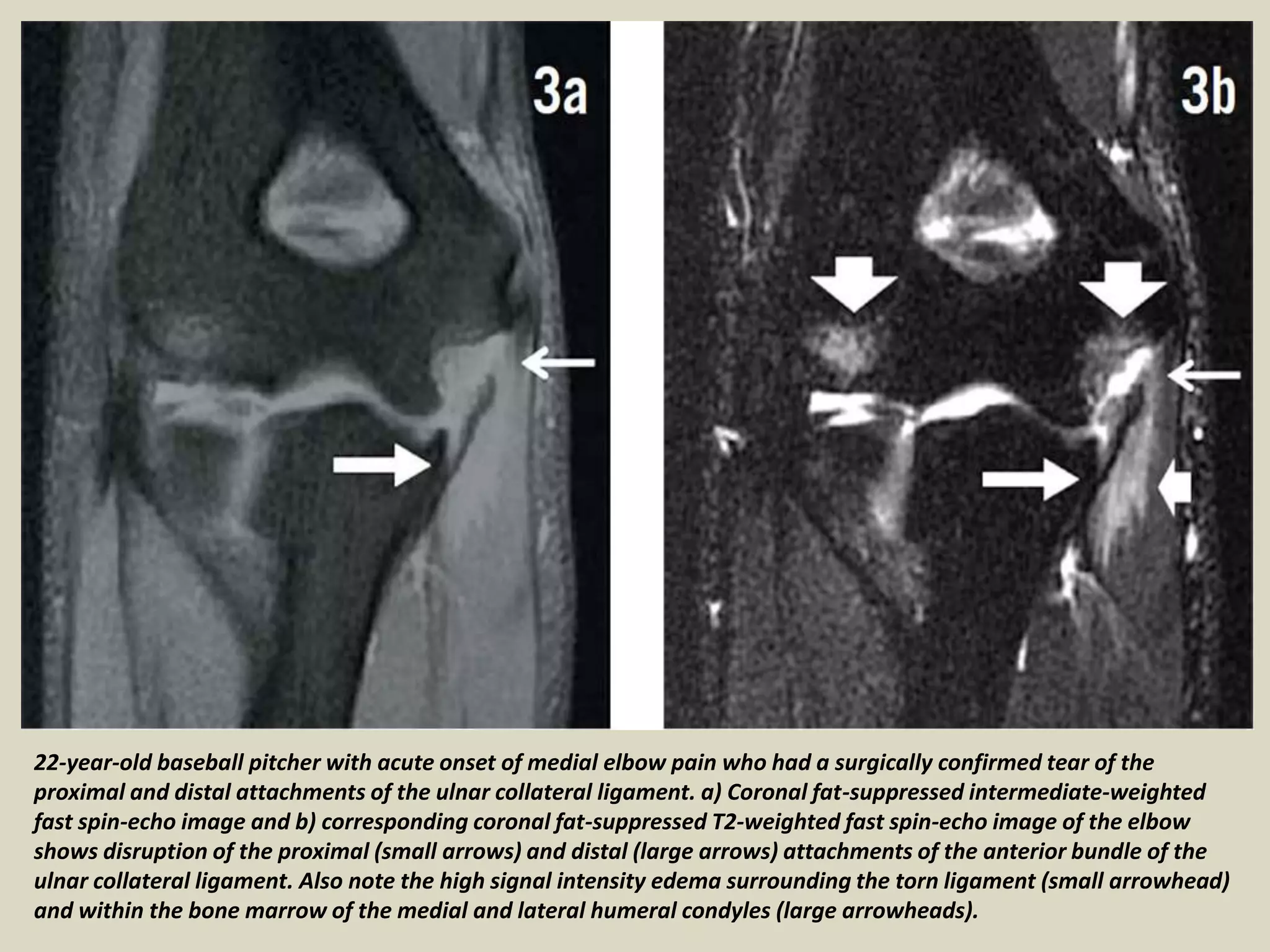 Presentation1, radiological film reading of elbow joint. | PPTX