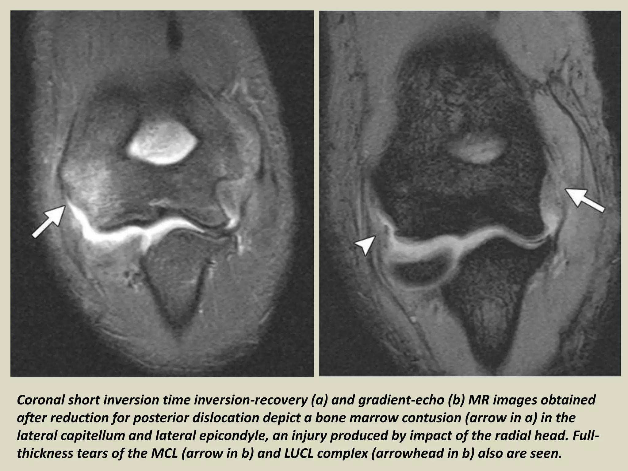 Presentation1, radiological film reading of elbow joint. | PPTX