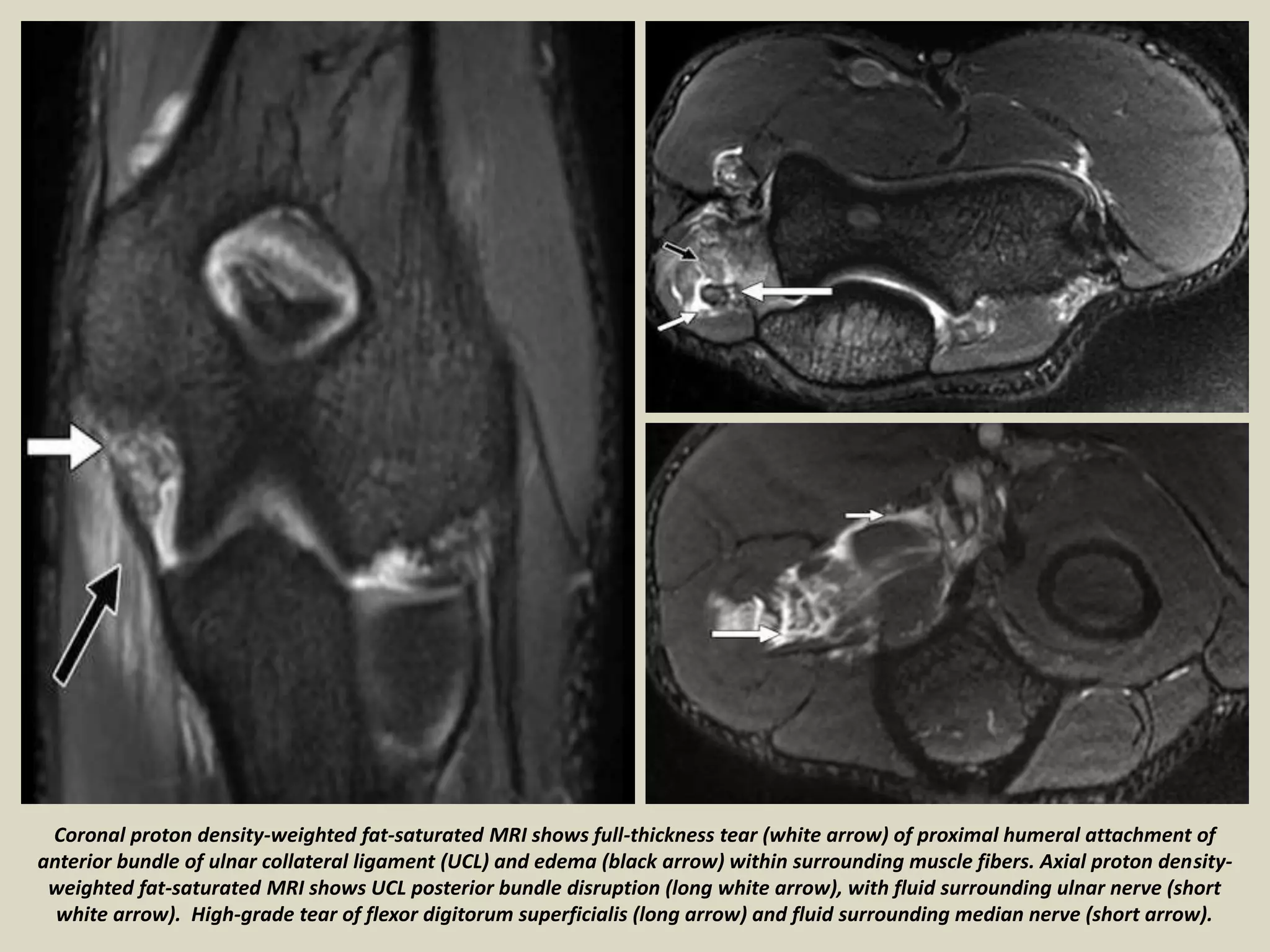 Presentation1, radiological film reading of elbow joint. | PPTX