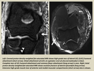Presentation1, radiological film reading of elbow joint. | PPTX