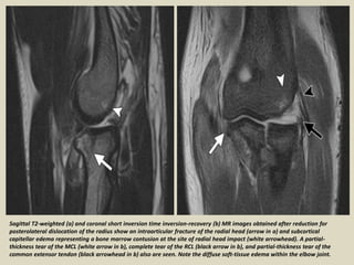 Presentation1, radiological film reading of elbow joint. | PPTX