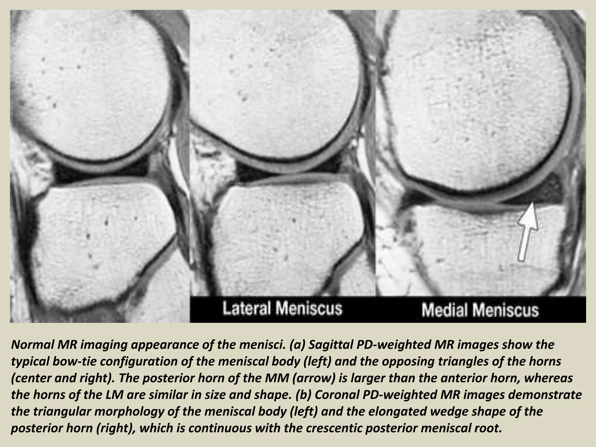 Presentation1, radiological film reading of knee joint. | PPTX