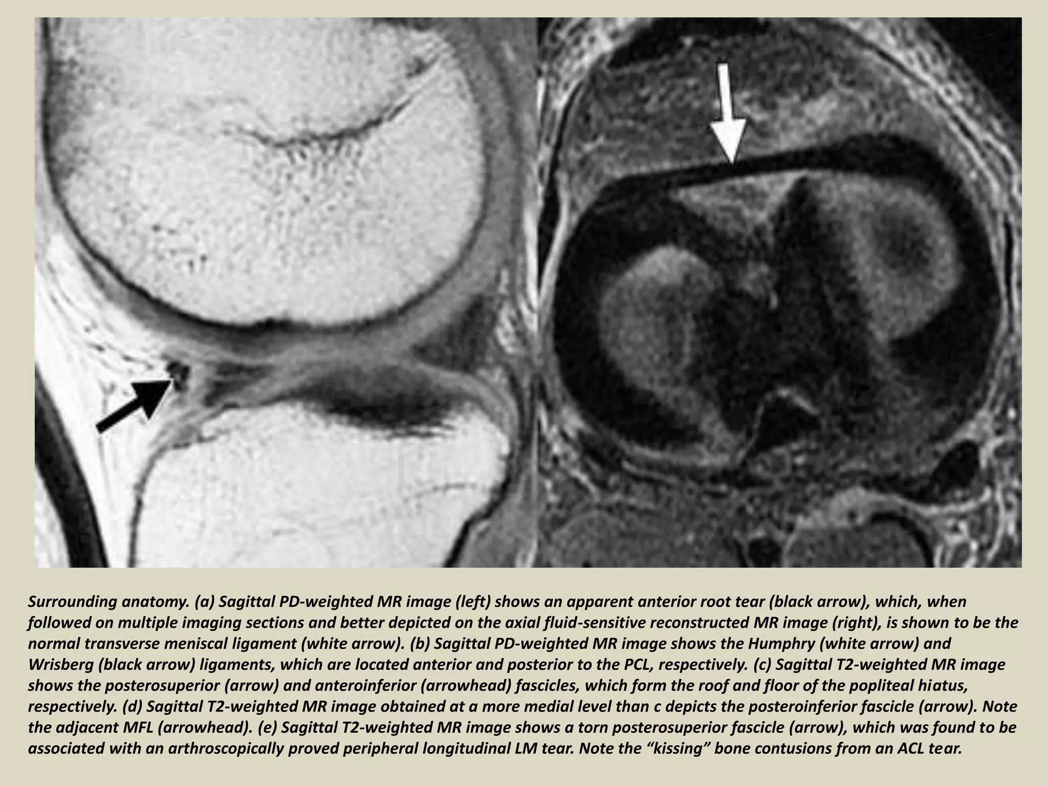 Presentation1, radiological film reading of knee joint. | PPTX