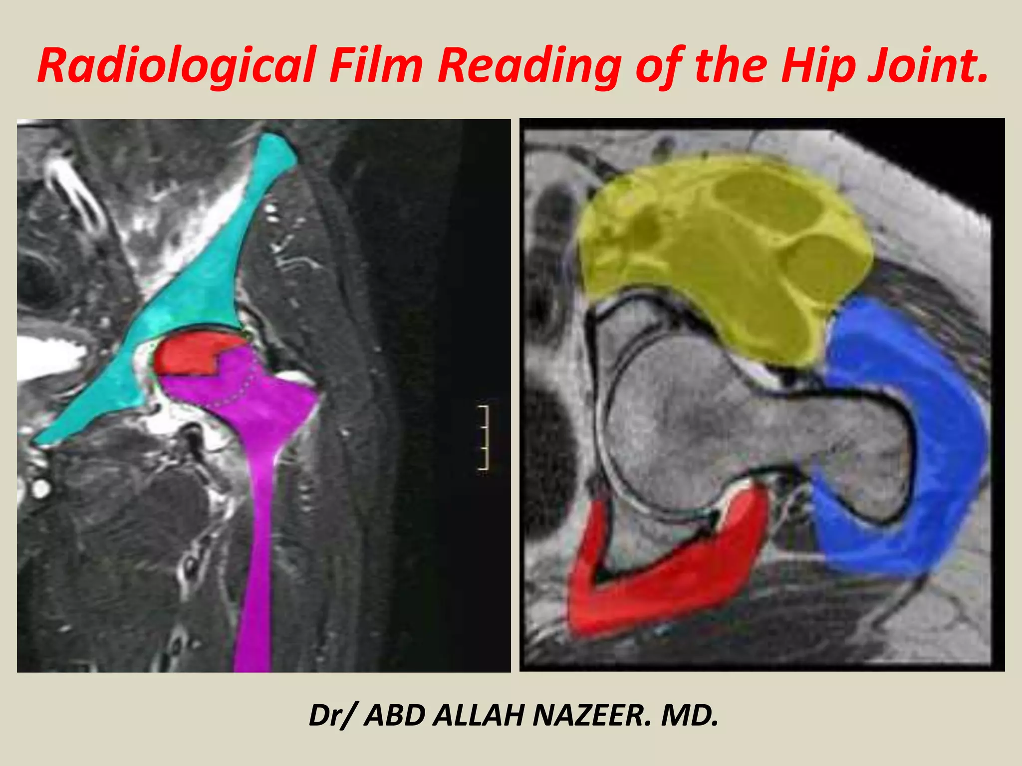 Presentation1, radiological film reading of the hip joint. | PPT