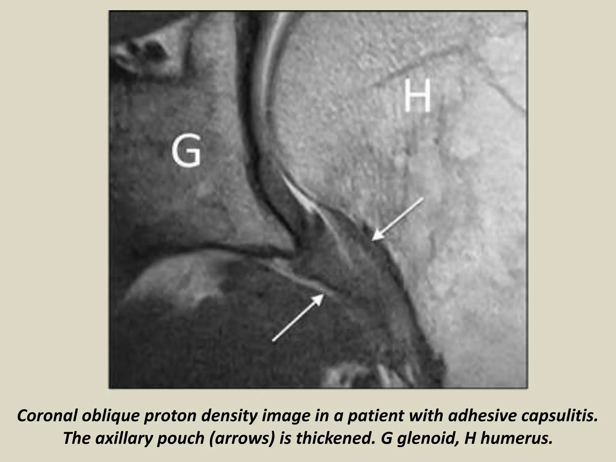 Presentation1, radiological imaging of adhesive capsulitis(frozen ...