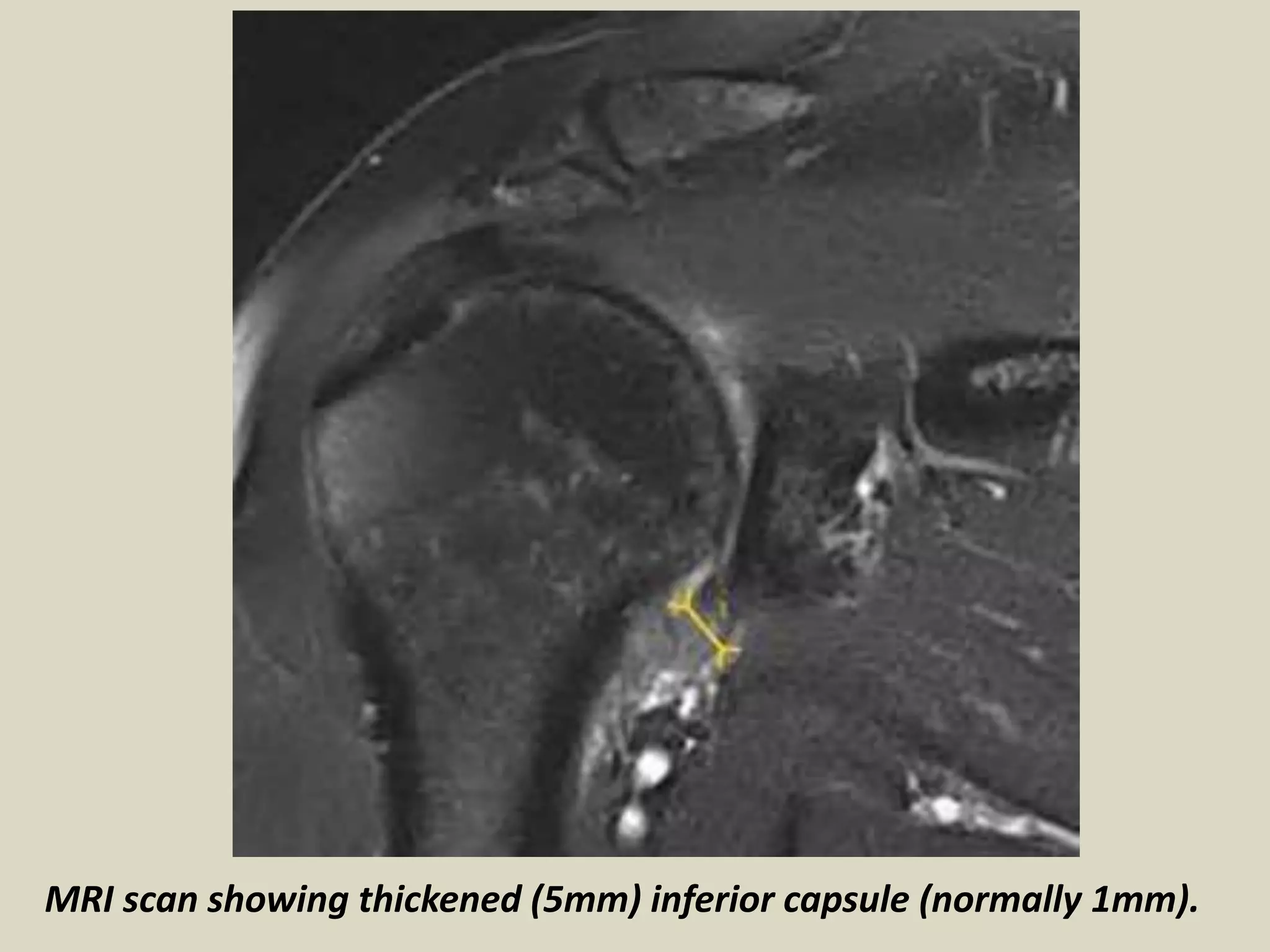 Presentation1, radiological imaging of adhesive capsulitis(frozen ...