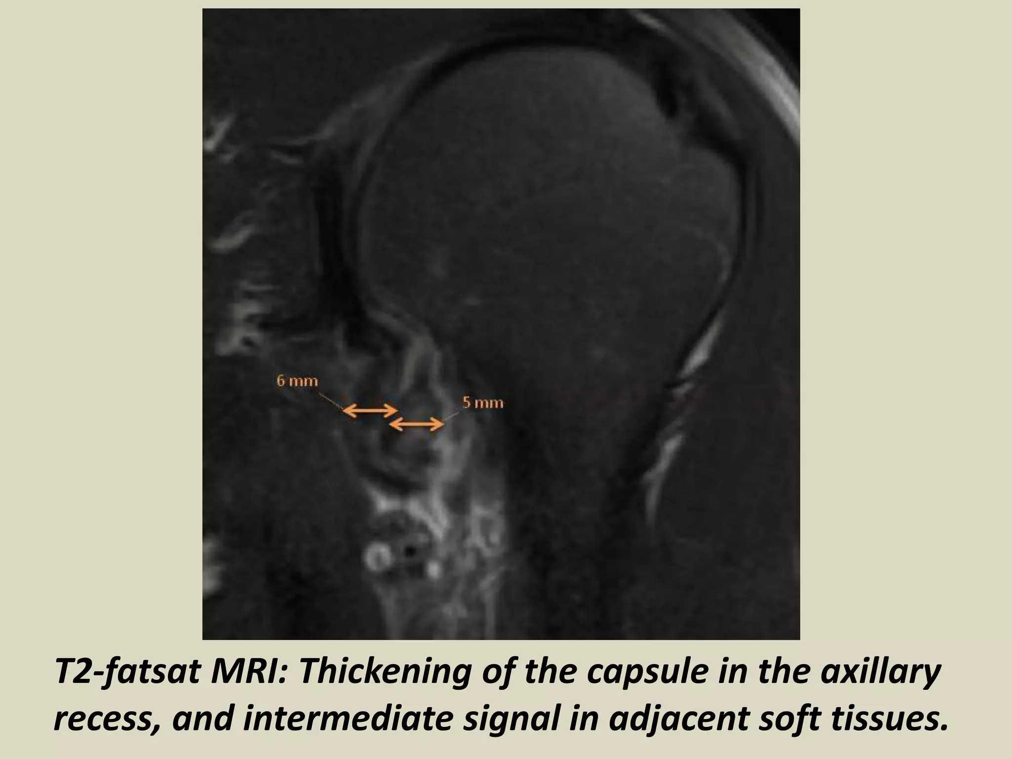 Presentation1, radiological imaging of adhesive capsulitis(frozen ...
