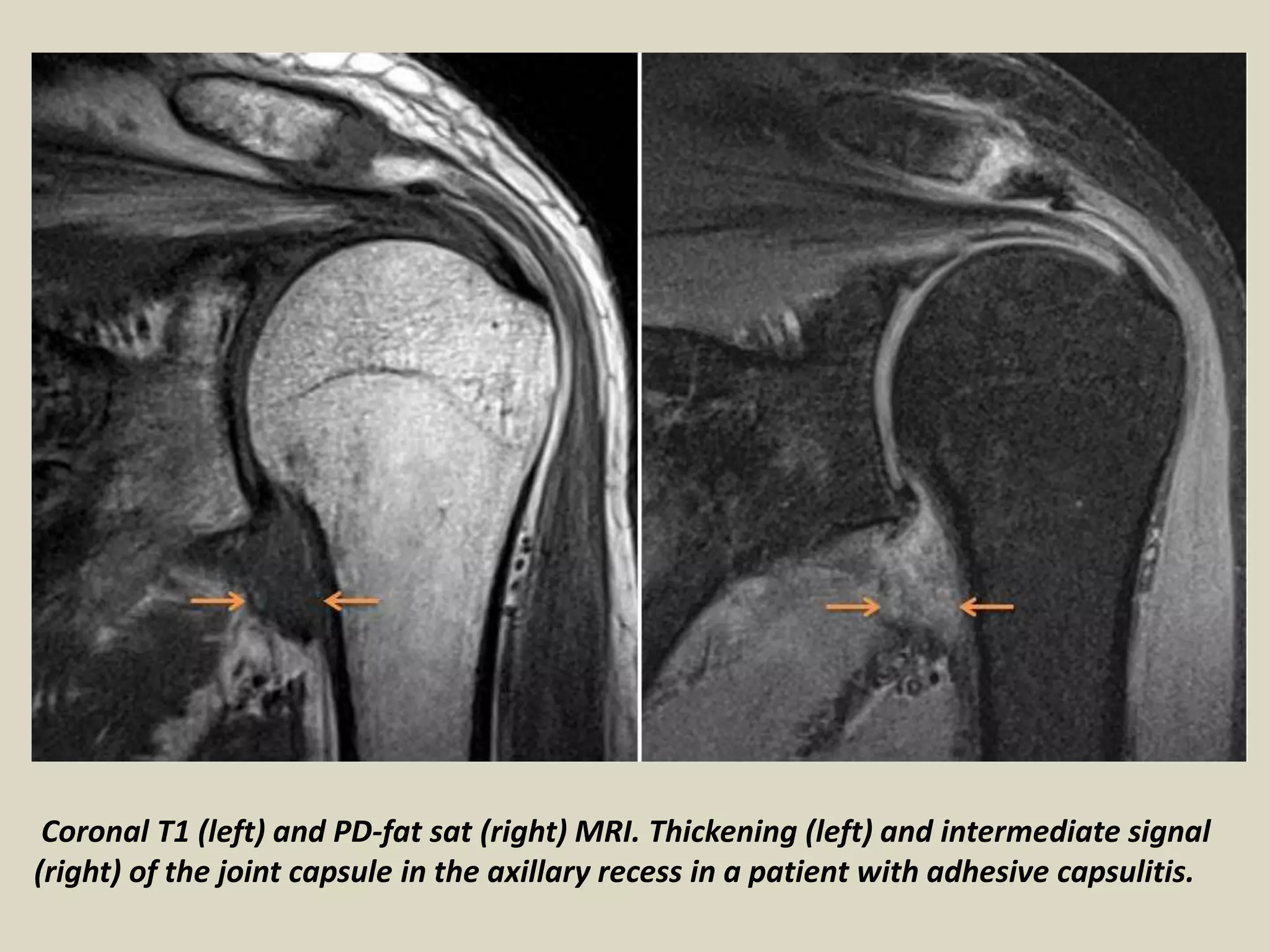 Presentation1, radiological imaging of adhesive capsulitis(frozen ...