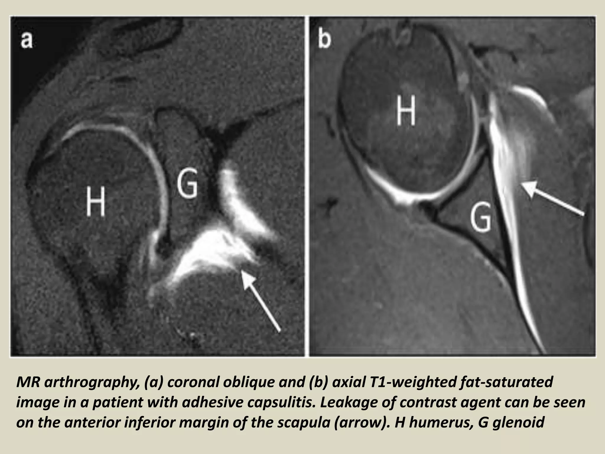 Presentation1, radiological imaging of adhesive capsulitis(frozen ...