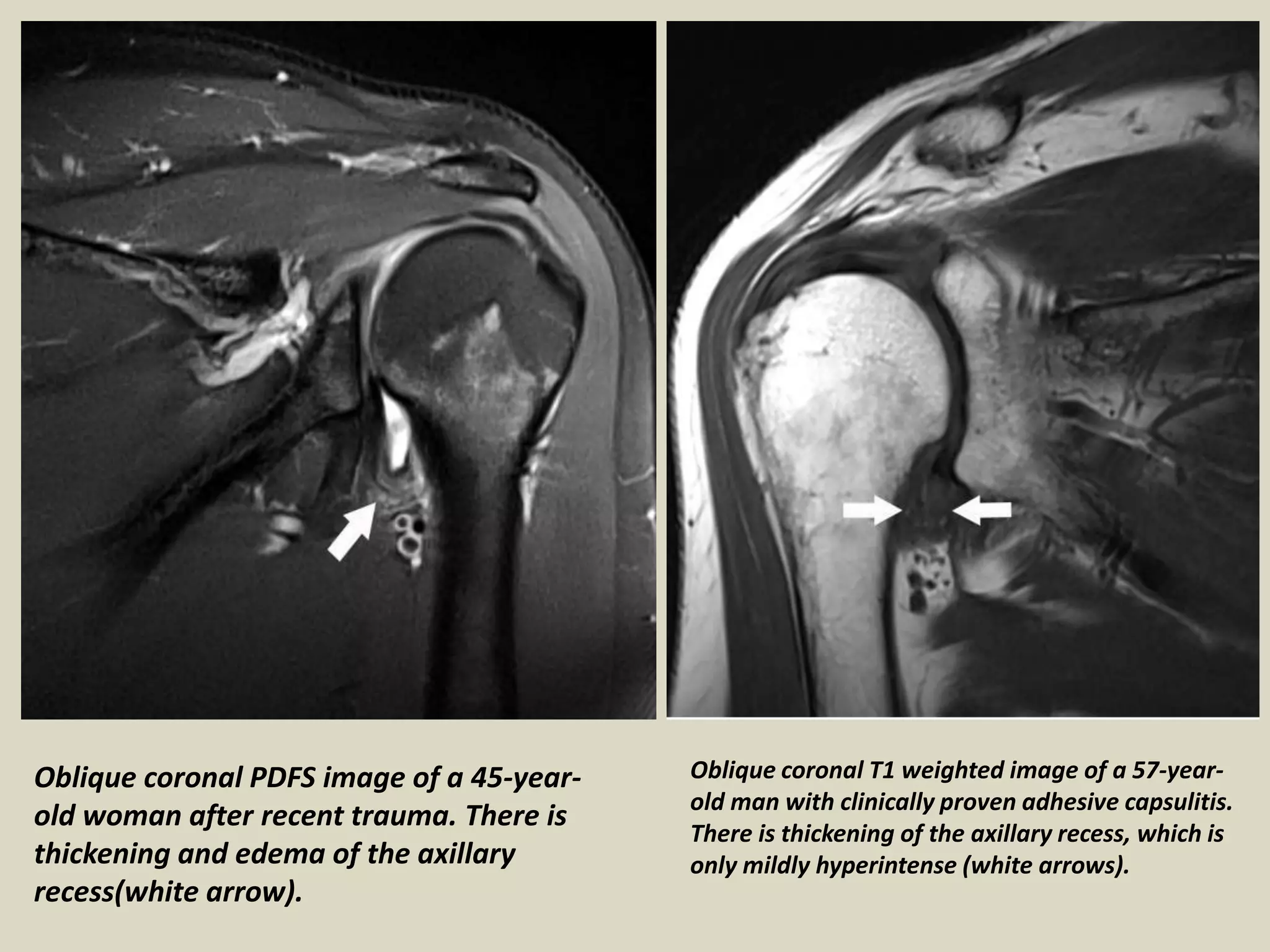 Presentation1, radiological imaging of adhesive capsulitis(frozen ...