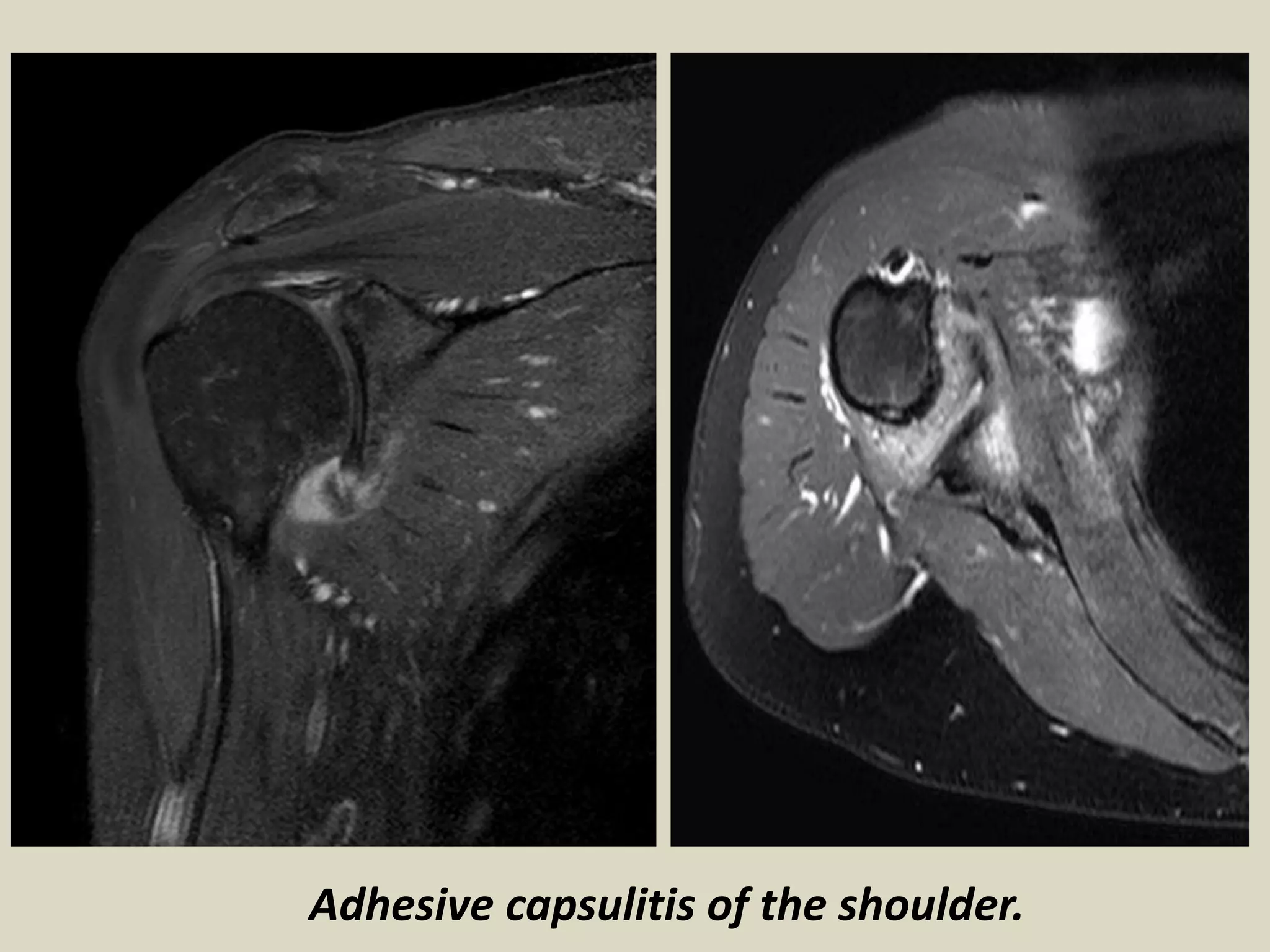 Presentation1, radiological imaging of adhesive capsulitis(frozen ...