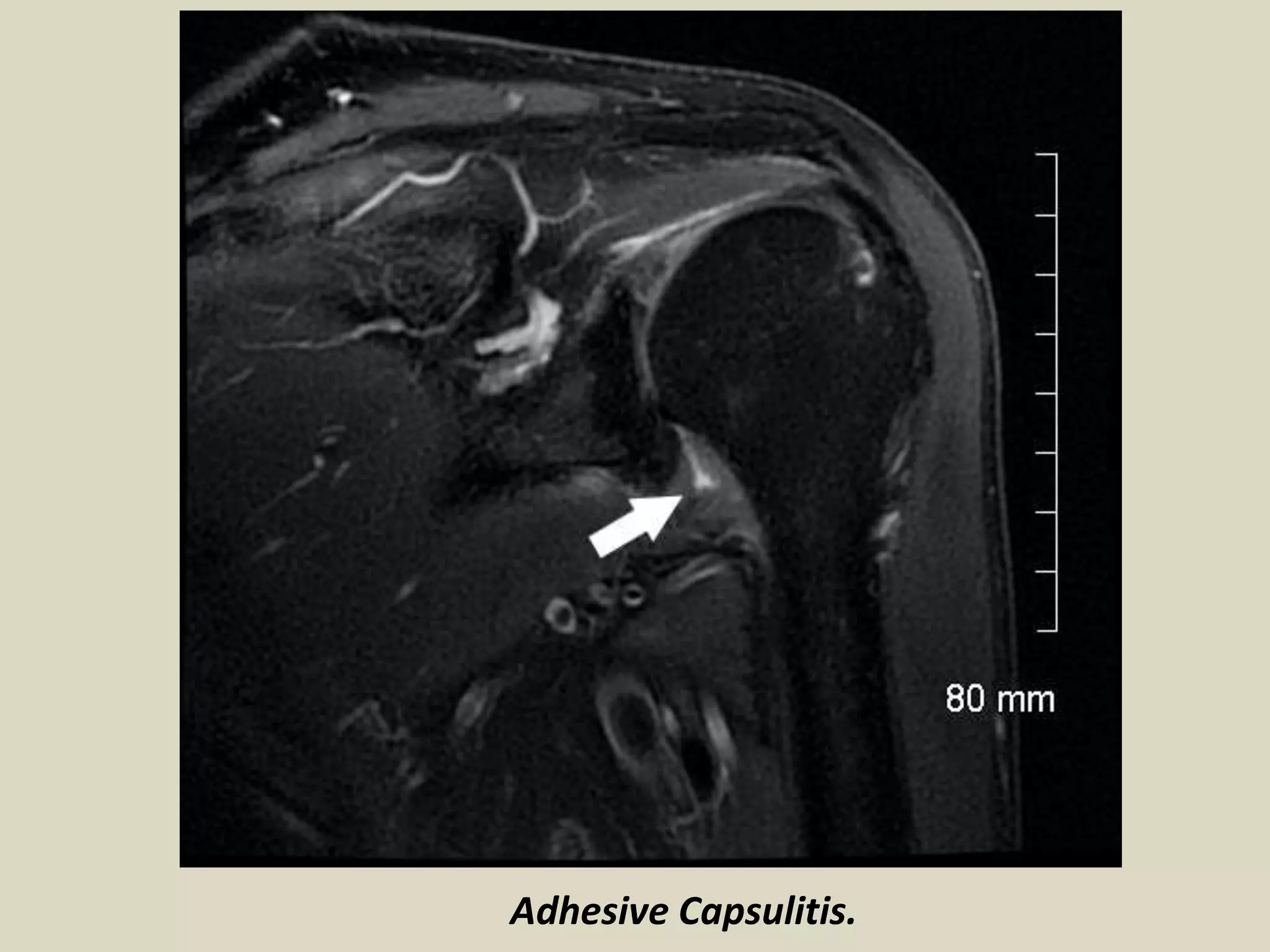Presentation1, radiological imaging of adhesive capsulitis(frozen ...