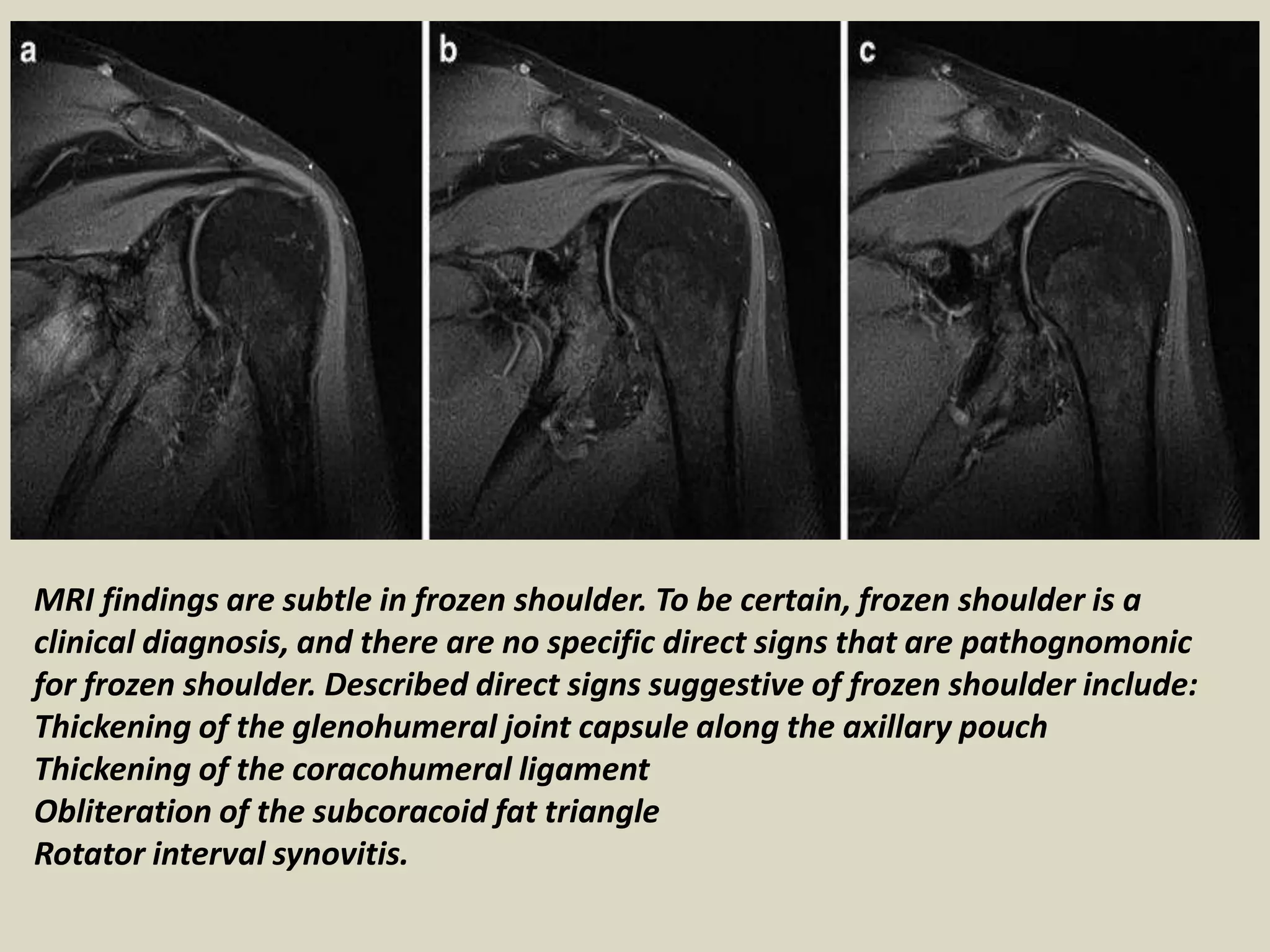 Presentation1, radiological imaging of adhesive capsulitis(frozen ...