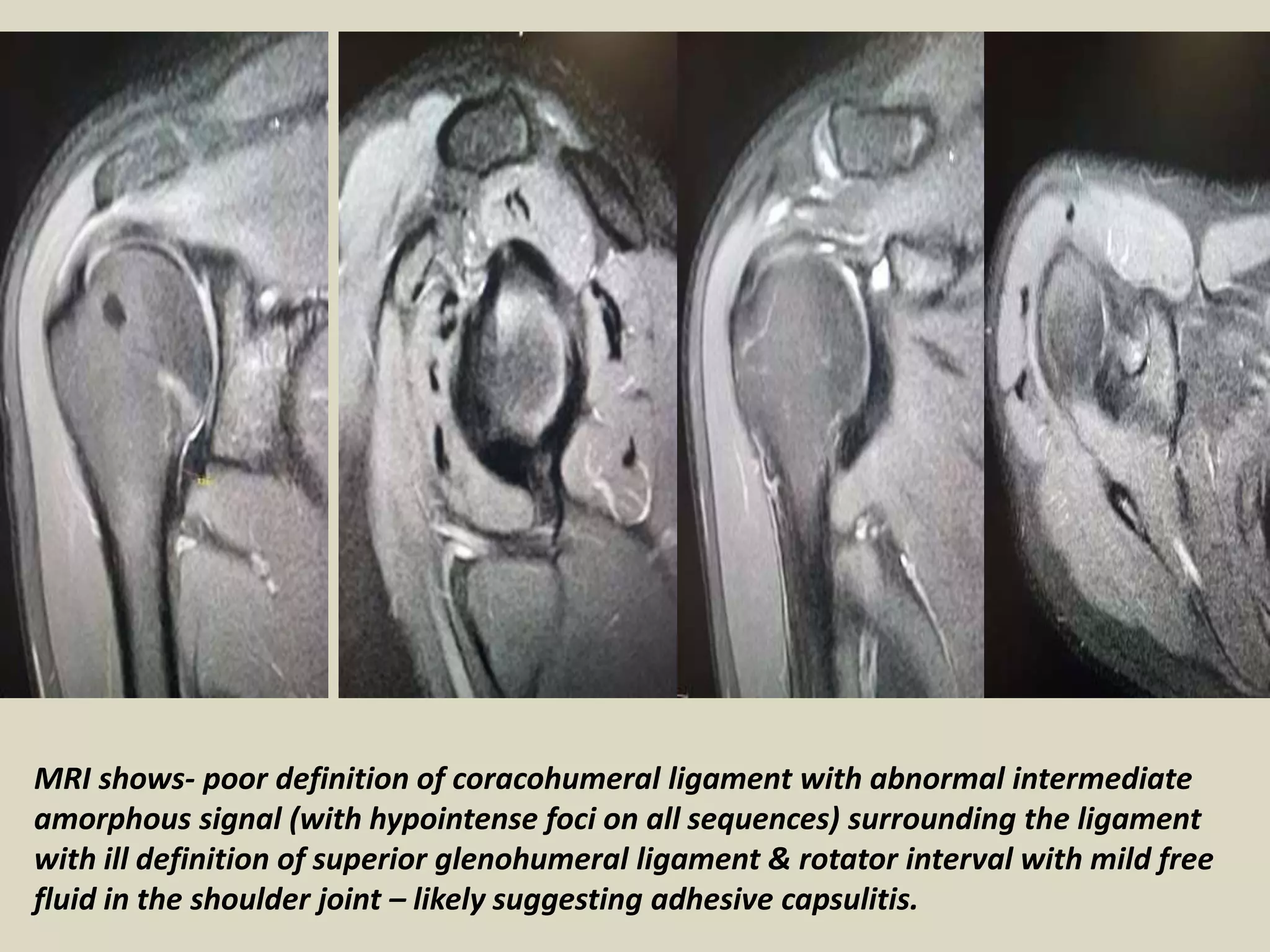 Presentation1, radiological imaging of adhesive capsulitis(frozen ...